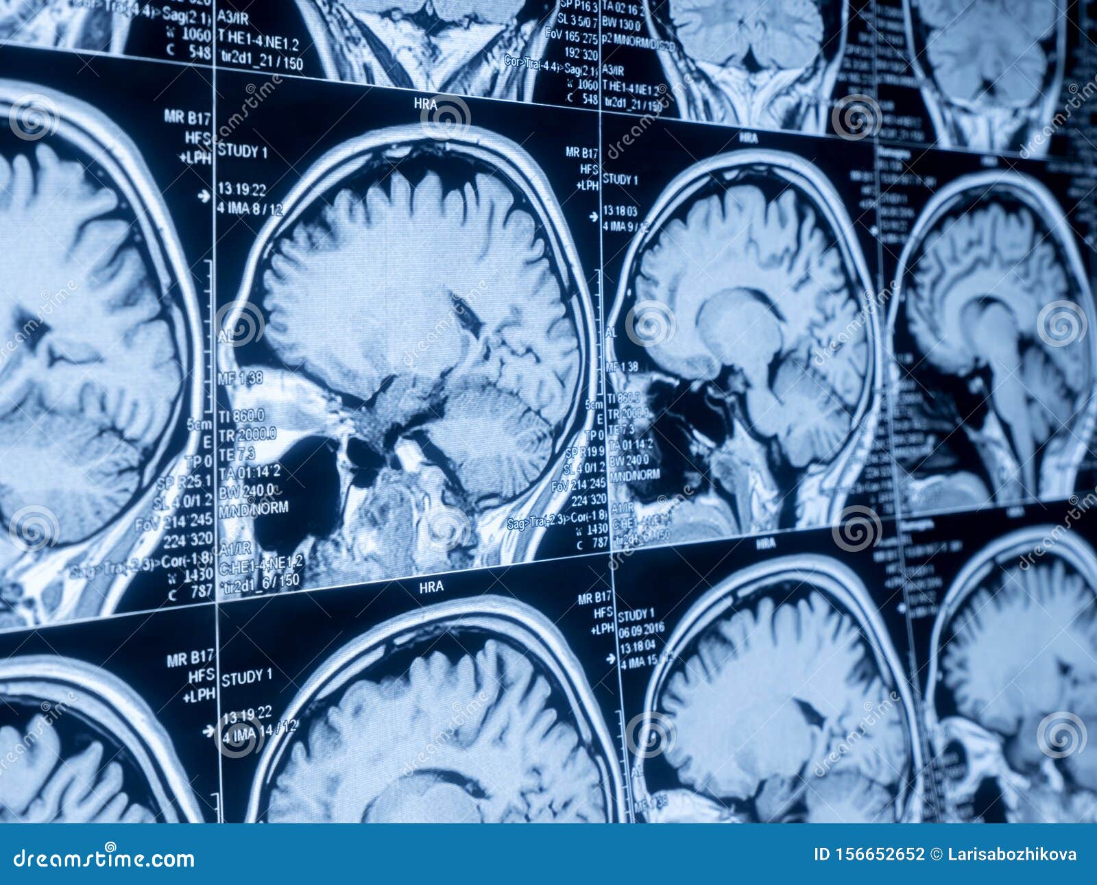 MRI Brain Scan of Head and Skull Stock Photo - Image of body, brain ...