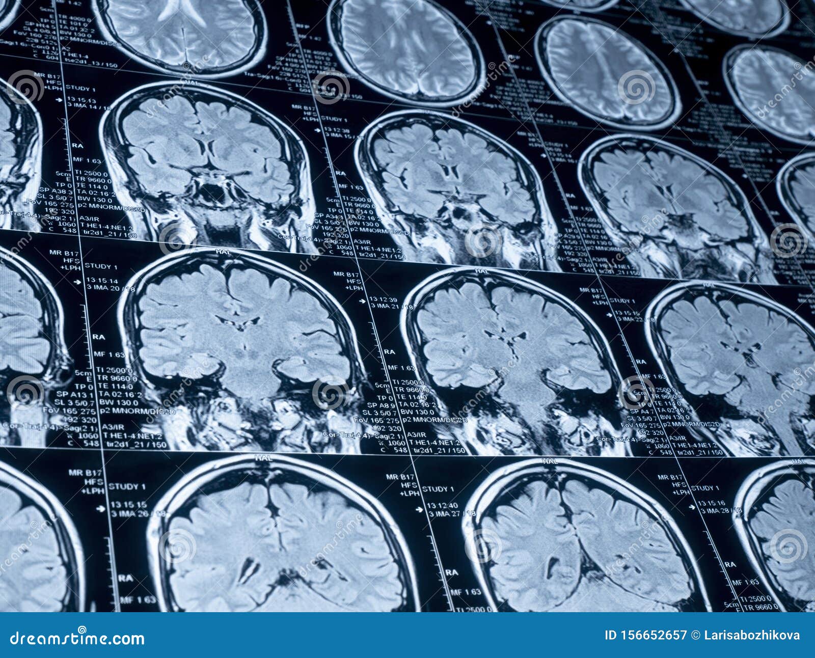 MRI Brain Scan of Head and Skull Stock Image - Image of healthcare ...