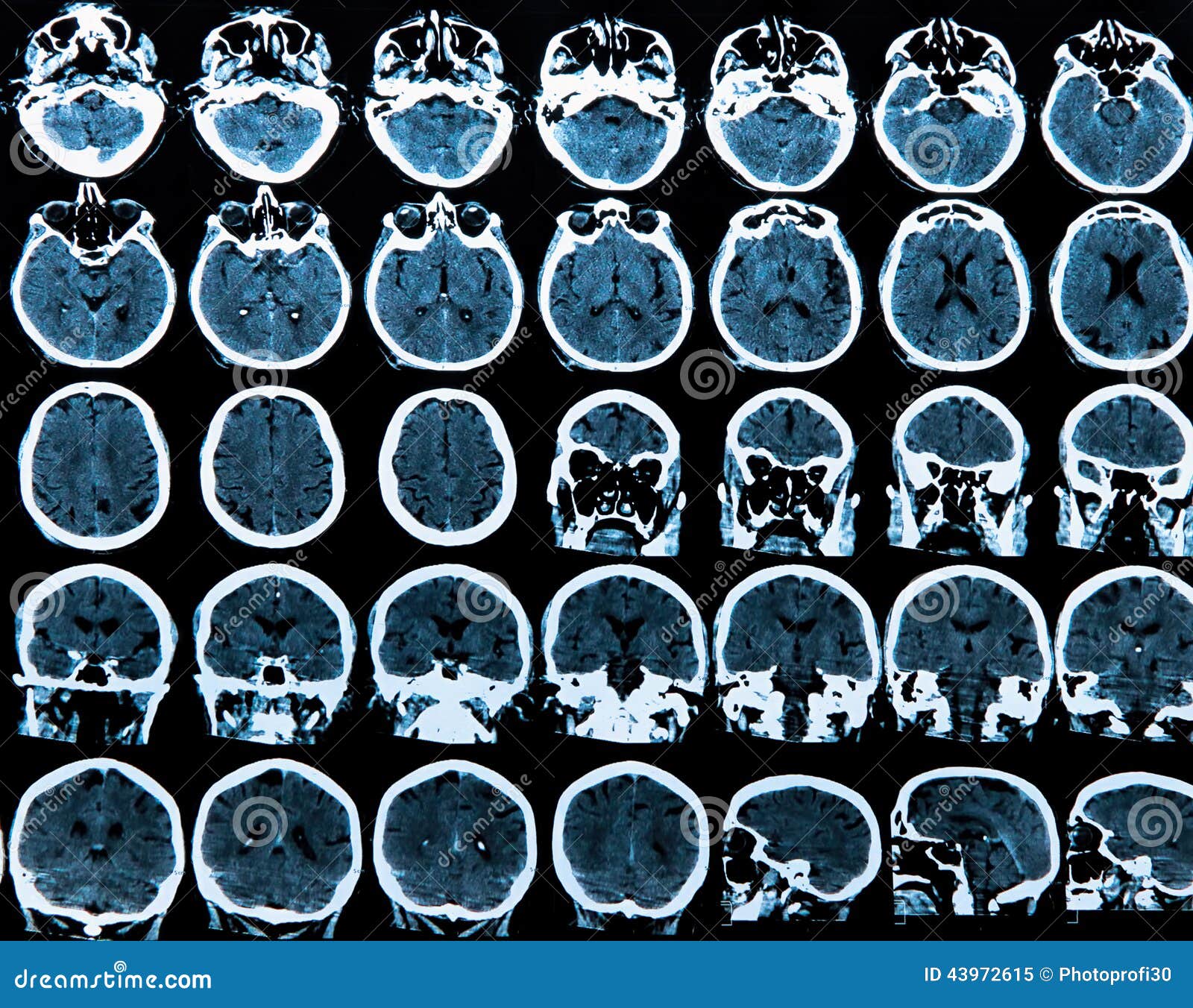 Mri Brain Scan stock image. Image of neural, cranium - 43972615