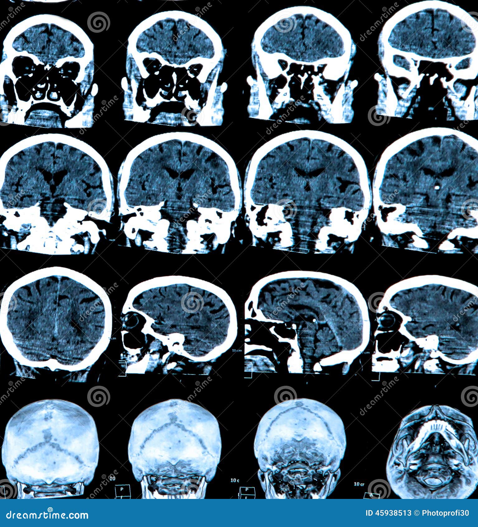 Mri Brain Scan stock image. Image of disease, diagnosis - 45938513