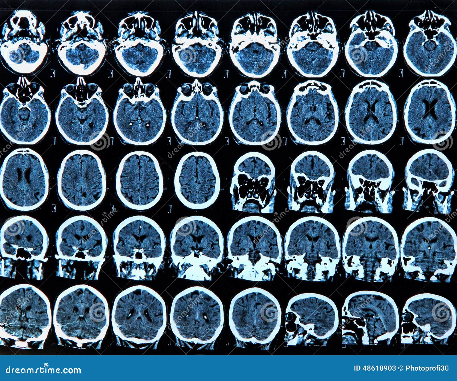 Mri Brain Scan editorial stock photo. Image of frontal - 48618903