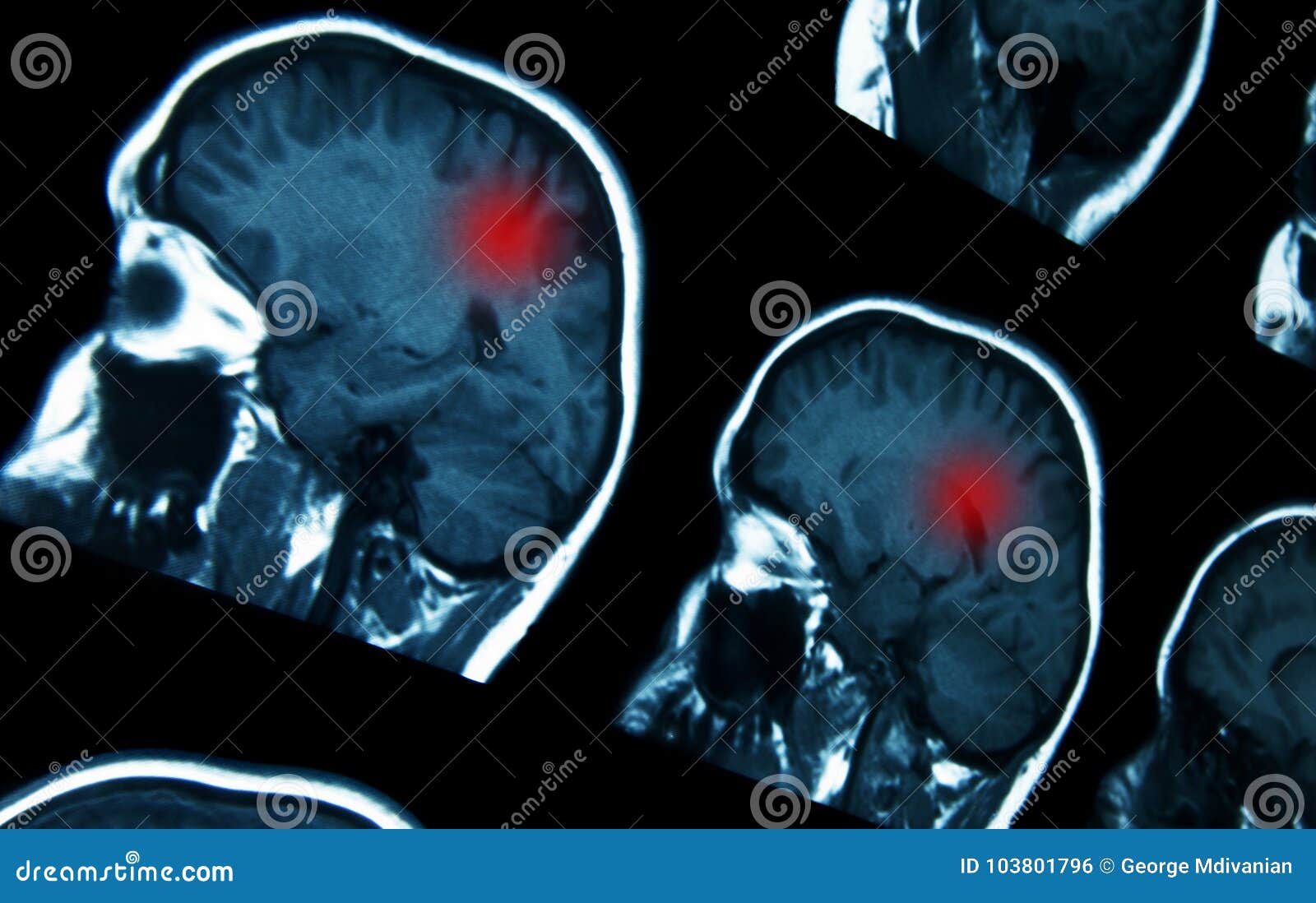 MRI brain scan stock photo. Image of problem, imaging - 103801796