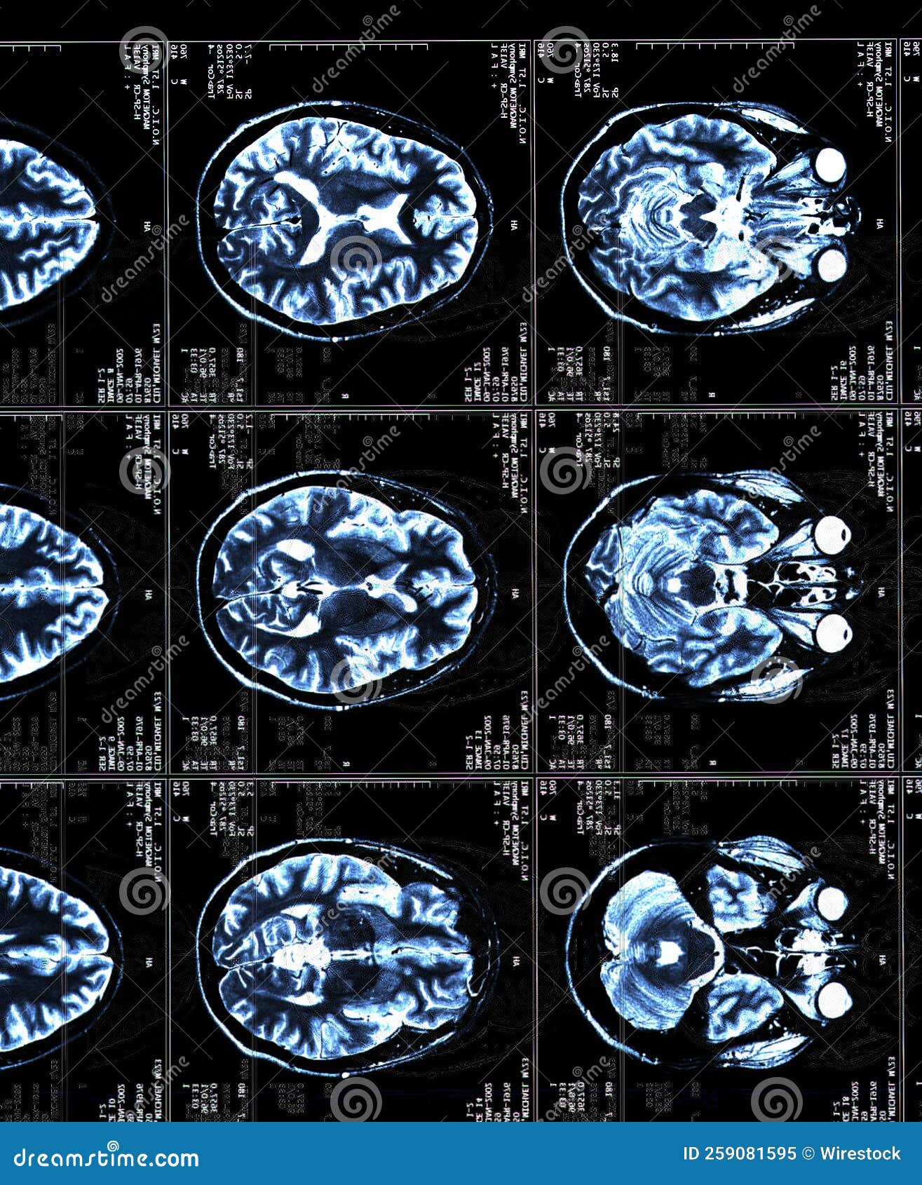 MRI Brain Scans of a Patient with Multiple Sclerosis Stock Image ...