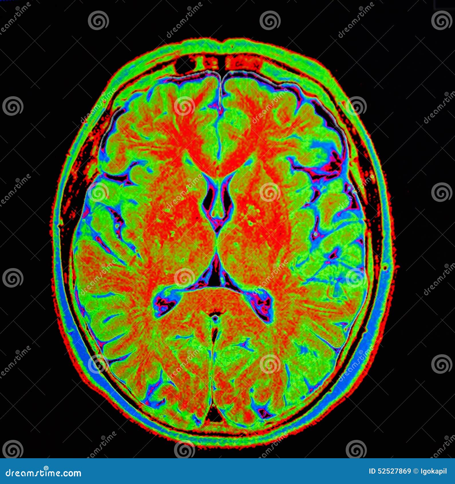 Mri Brain Stroke Stock Image Image Of Neurosurgeon Brain 52527869