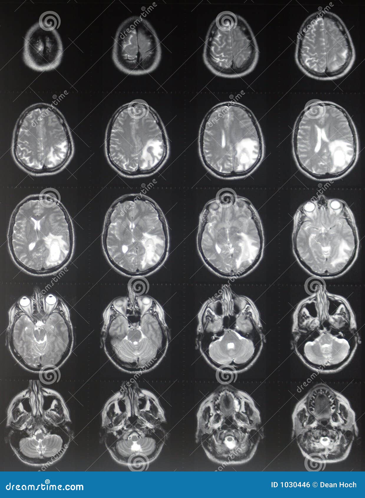Mri Brain Tumor Royalty Free Stock Image Image 1030446