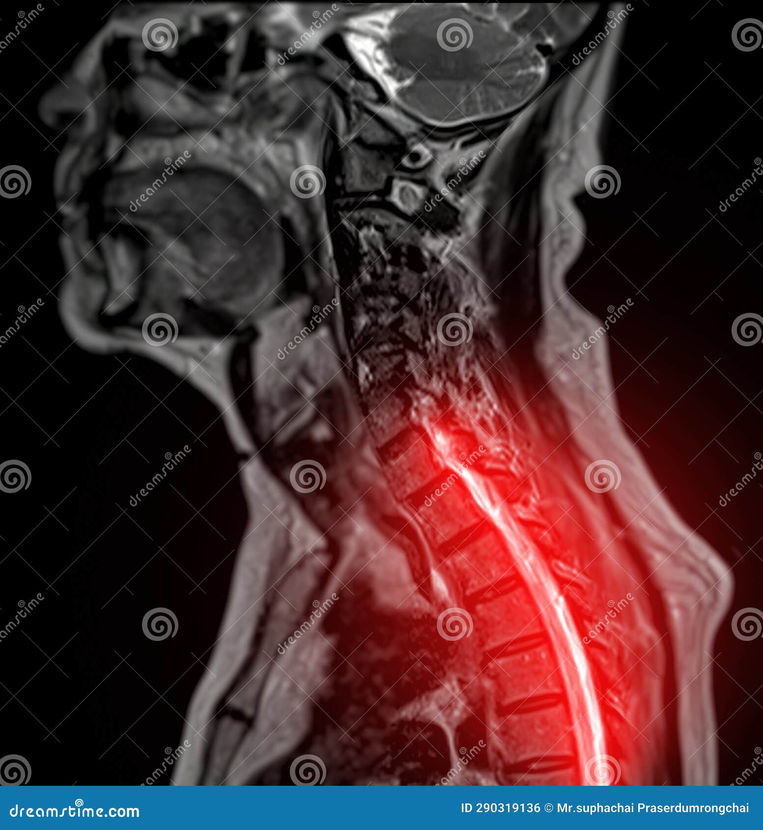 Mri Of C Spine Or Magnetic Resonance Image Of Cervical Spine Sagittal