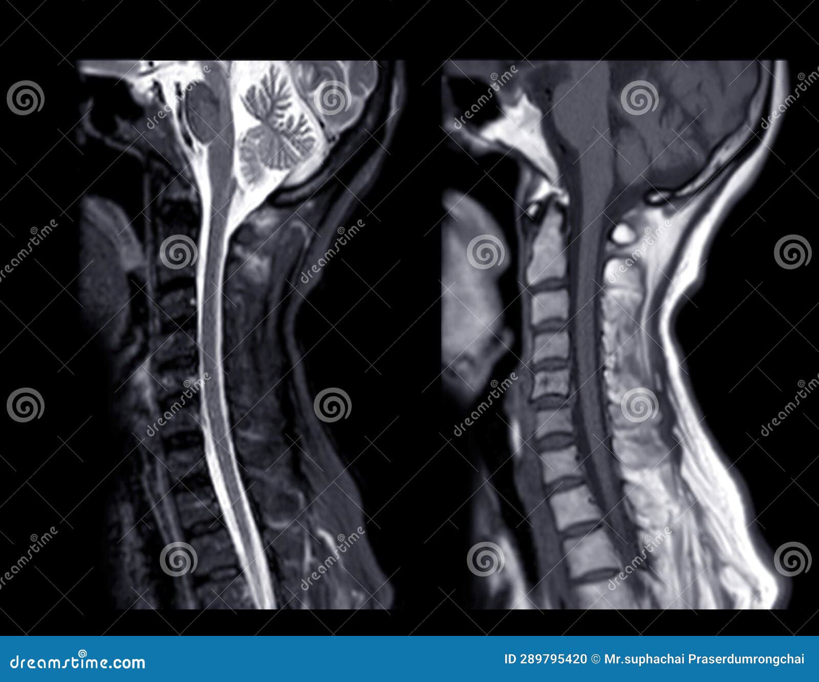 Mri Of C Spine Or Magnetic Resonance Image Of Cervical Spine Sagittal