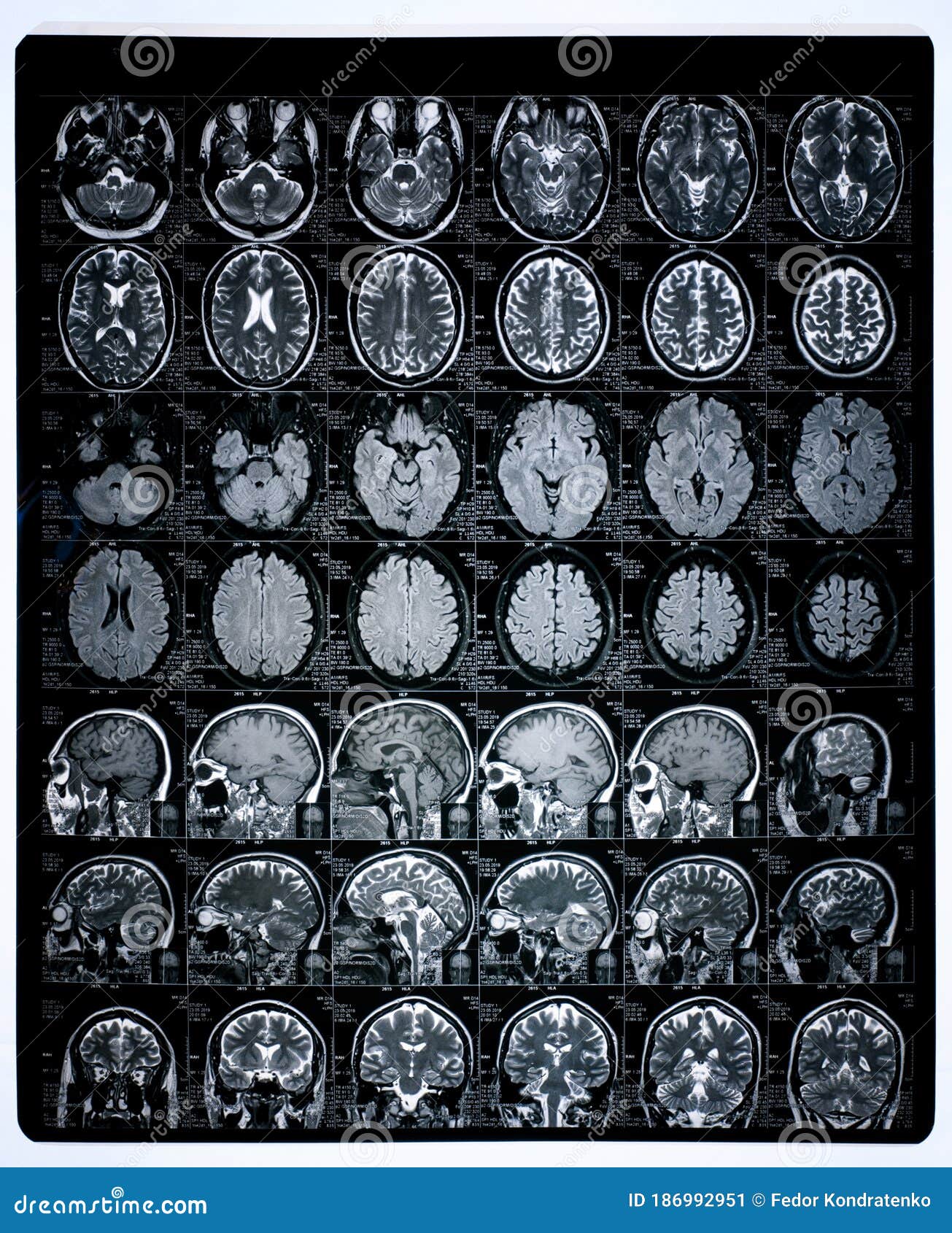 Mri Cerebral De Un Macho Adulto Imagen de archivo - Imagen de prueba ...