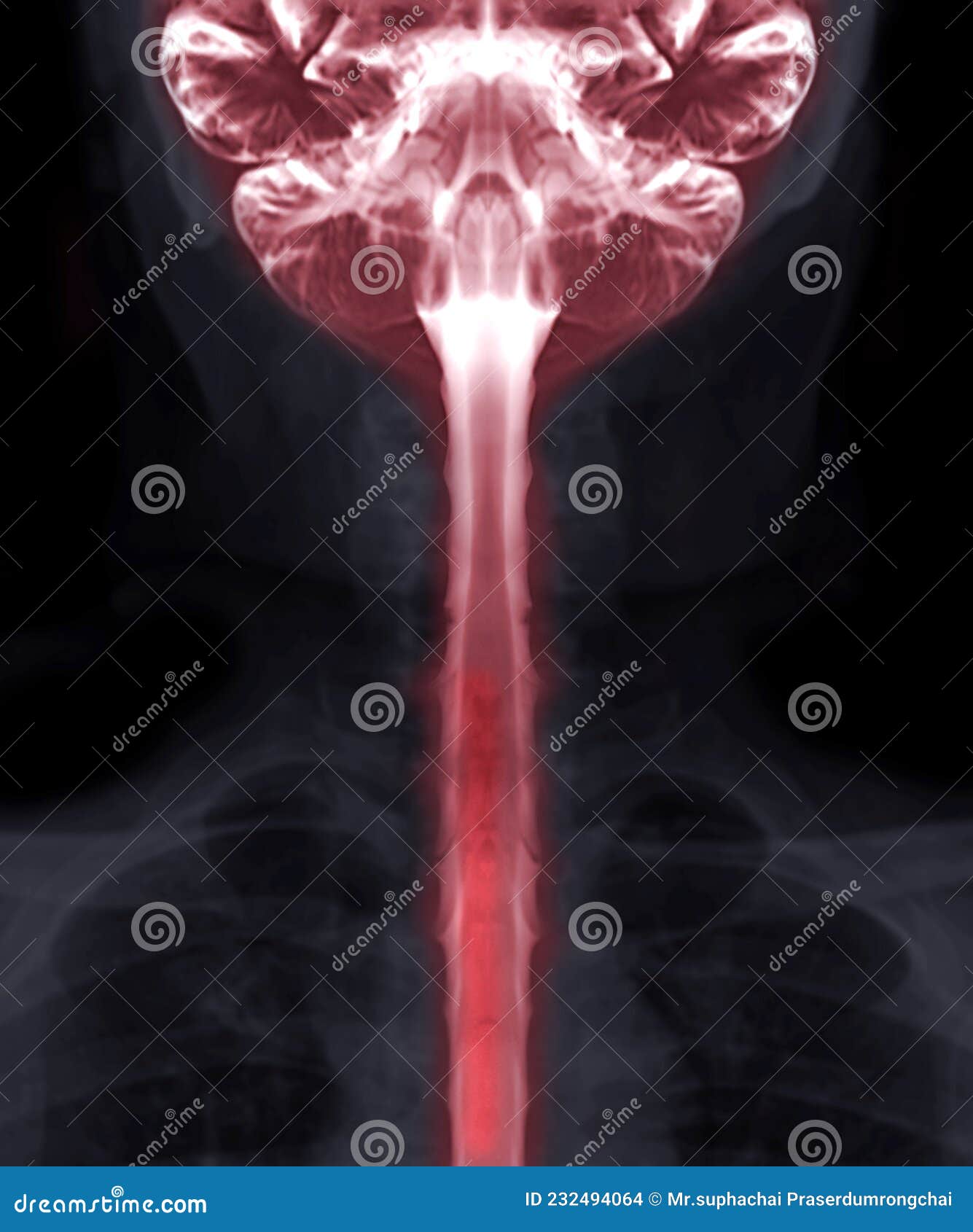 MRI Cervical Spine Myelogram Seqeunce for Diagnostic Spinal Cord ...