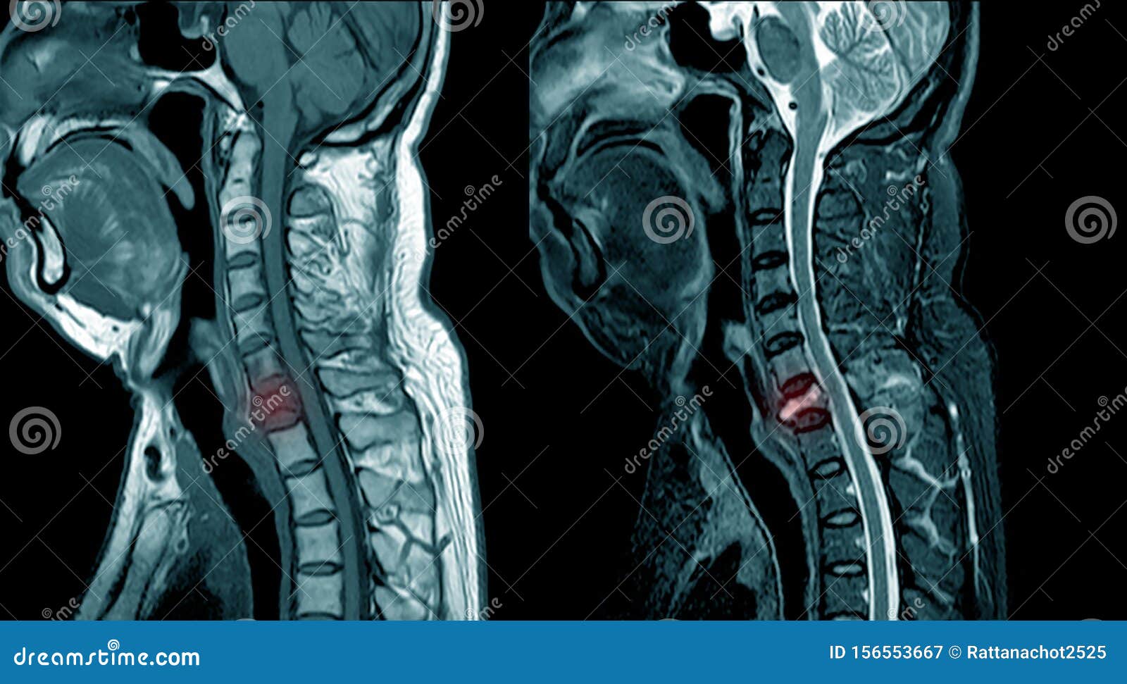 Mri Of Cervical Spine Spine Soft Tissue Mass Stock Image Image Of Compression Bone 156553667