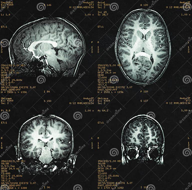 MRI of a child s brain stock photo. Image of skull, human - 9696156