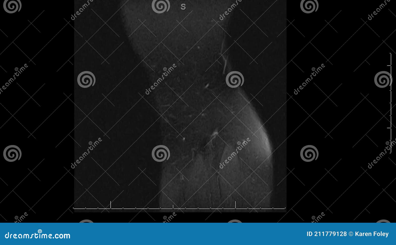 MRI of Knee without Contrast Stock Footage - Video of sequenced ...