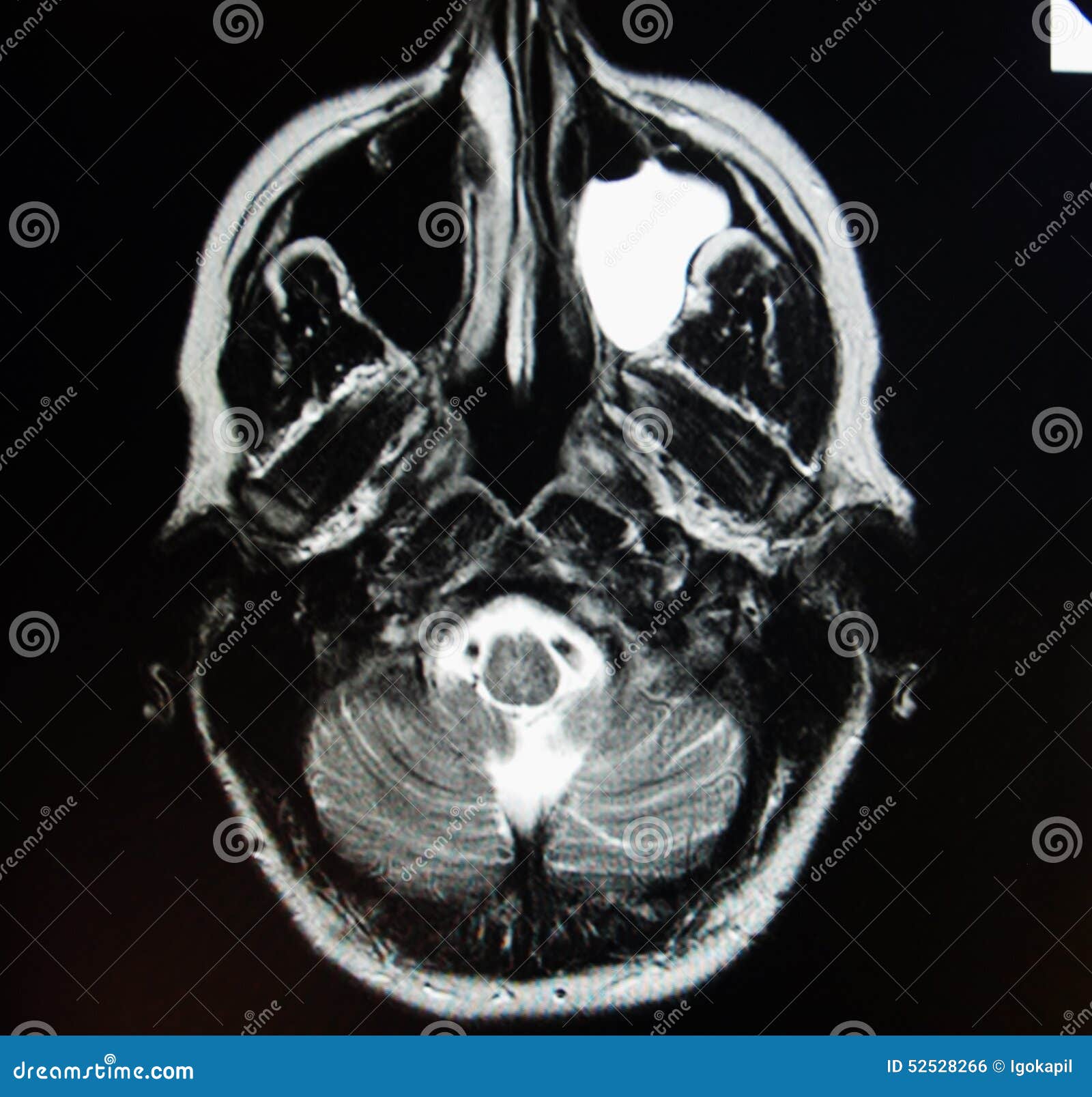 Mri de la sinusitis foto de archivo. Imagen de frente - 52528266