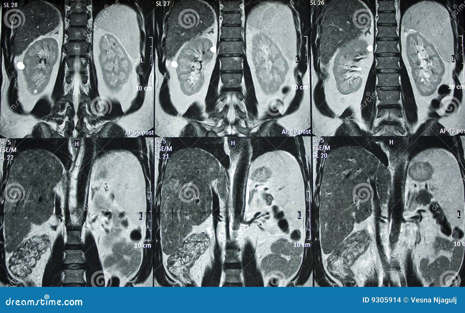 MRI del abdomen foto de archivo. Imagen de enfermo, vida - 9305914