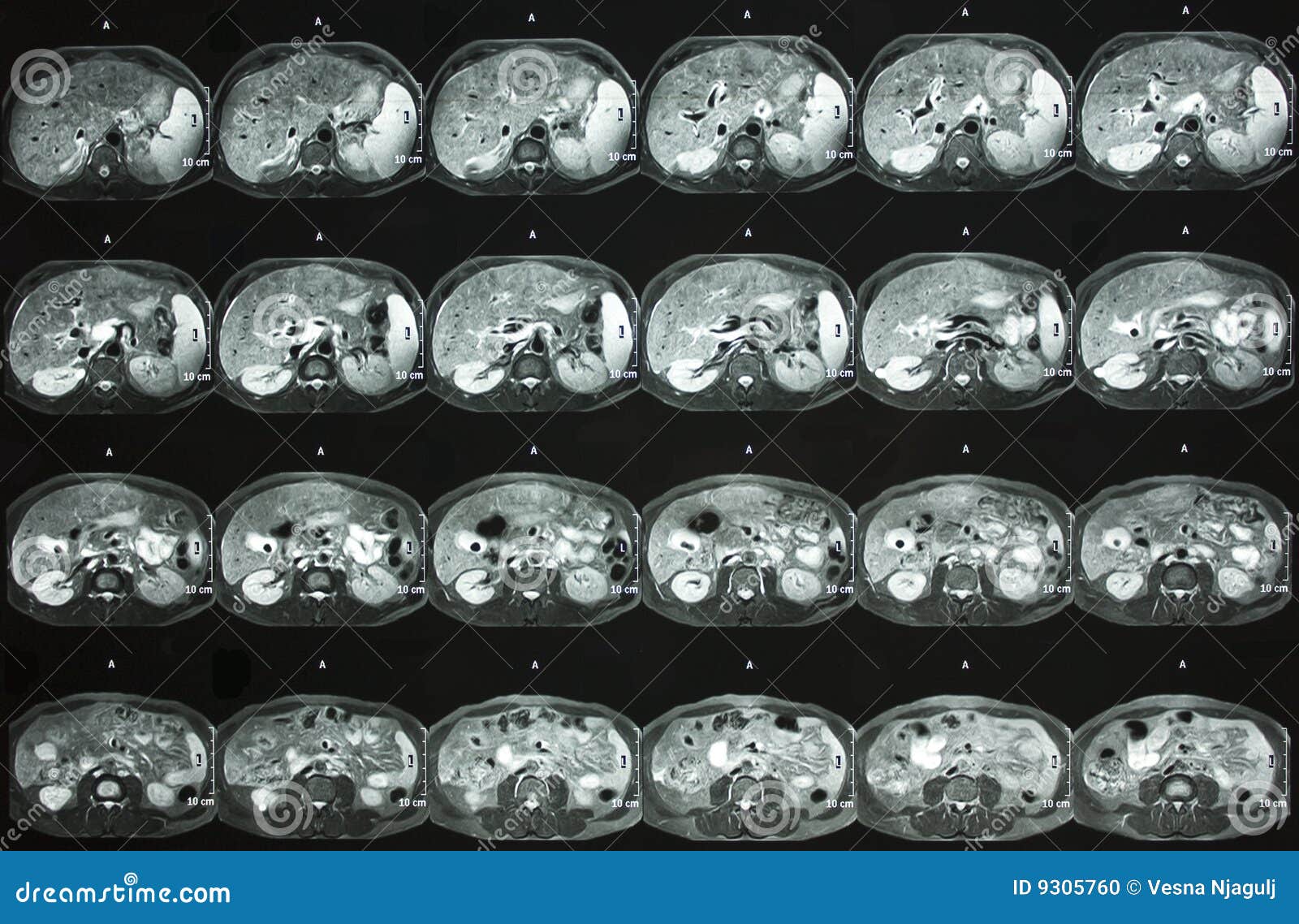 MRI dell'addome fotografia stock. Immagine di testa, corpo - 9305760