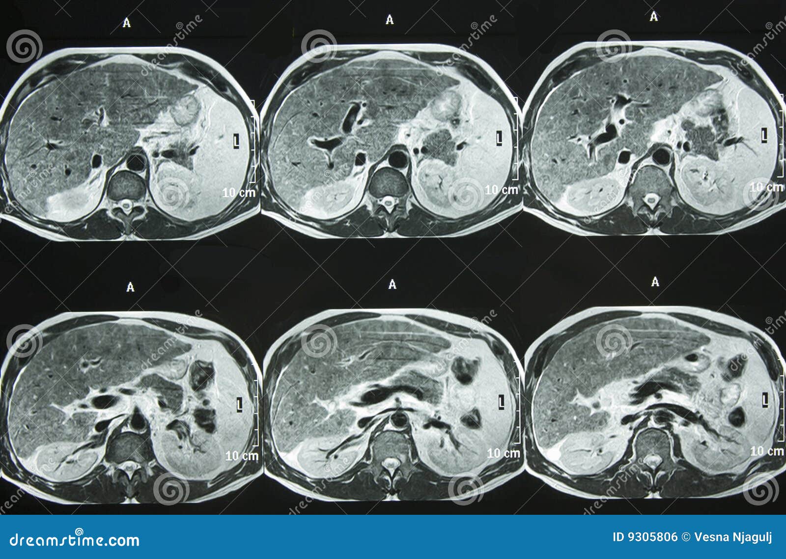 MRI dell'addome fotografia stock. Immagine di parti, corpo - 9305806