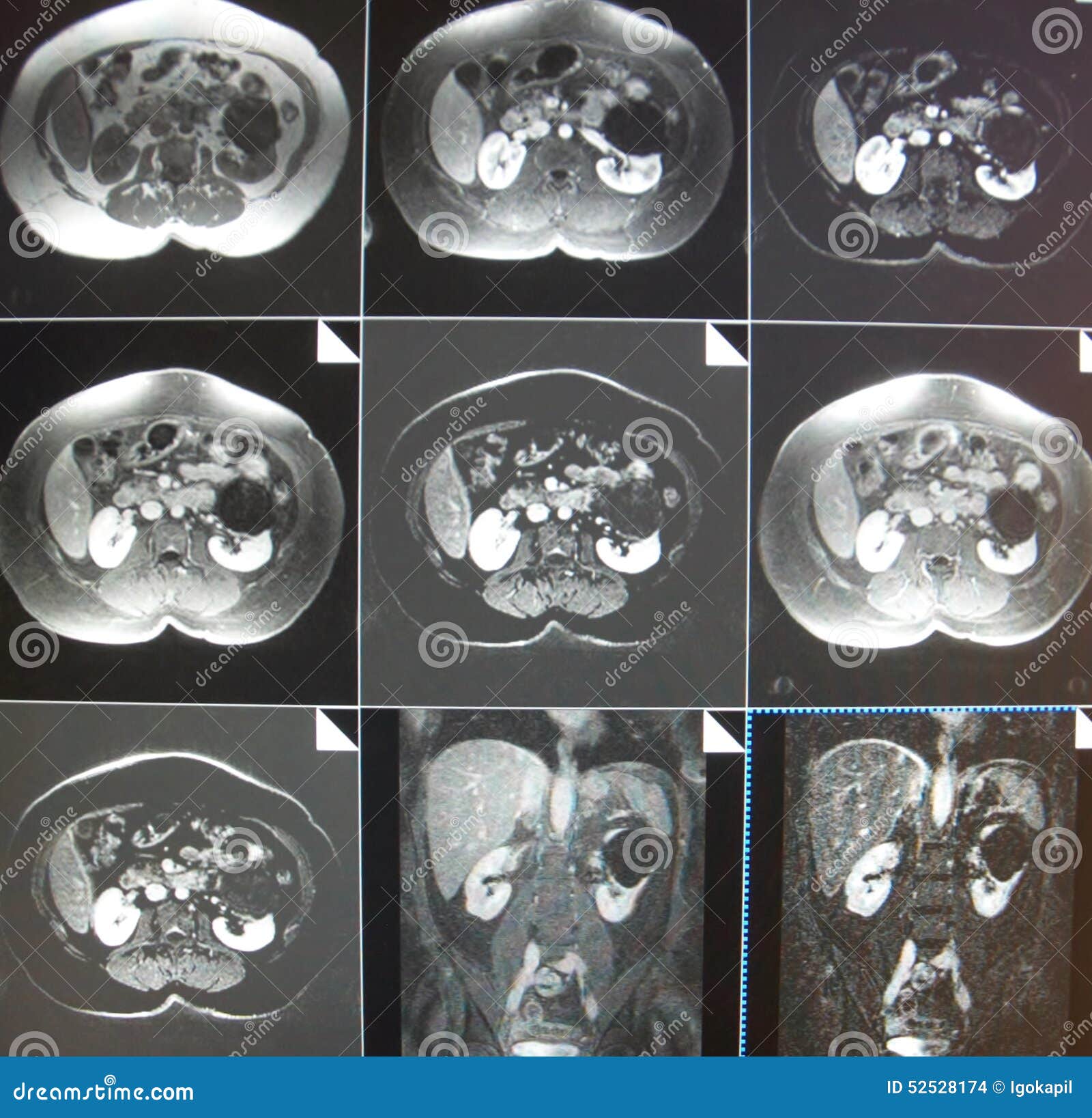 Mri der Nierenzyste stockfoto. Bild von betrieb, bereich - 52528174
