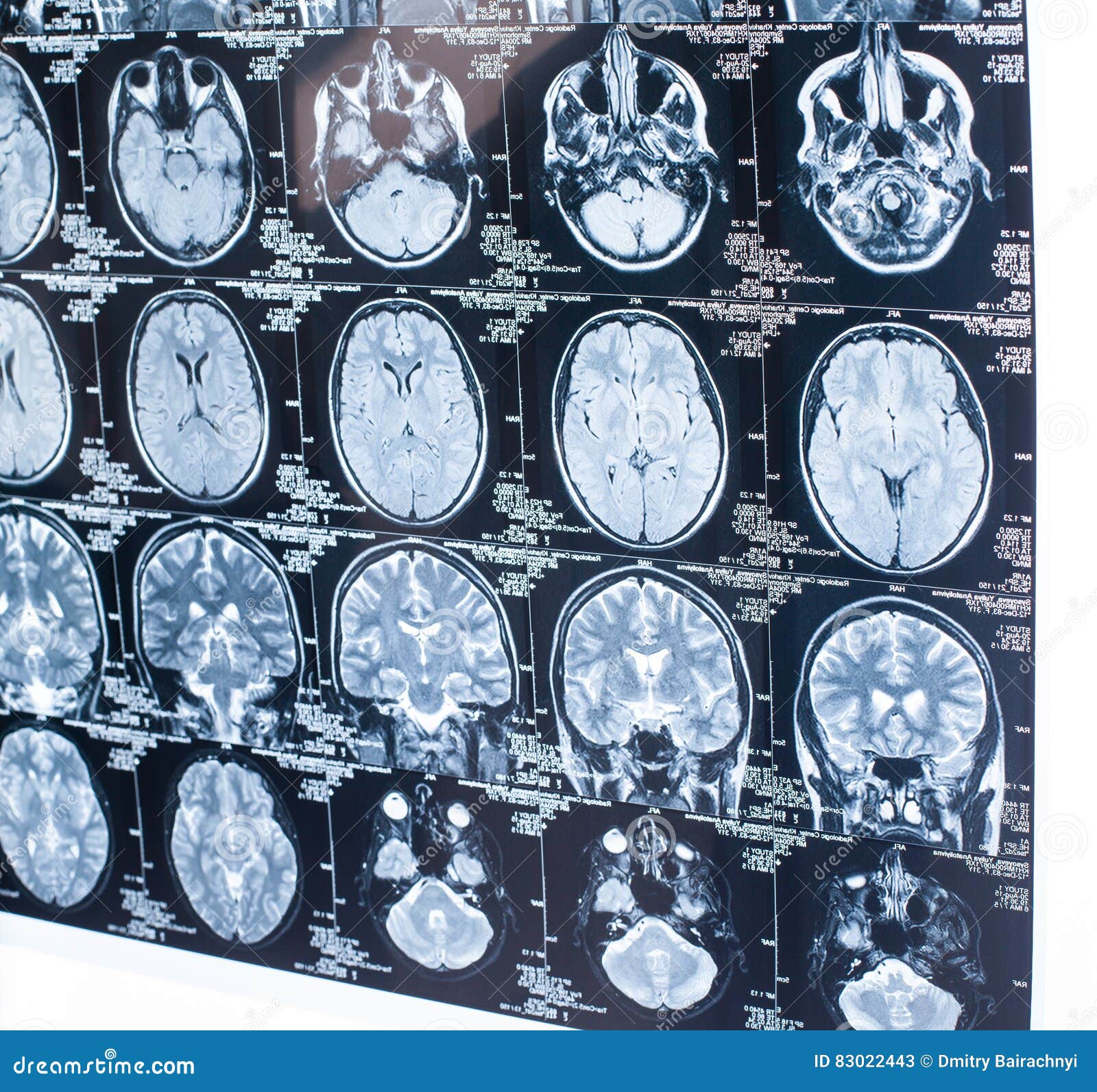 MRI-diagnostiek Van Menselijke Hersenen Stock Afbeelding - Image of ...