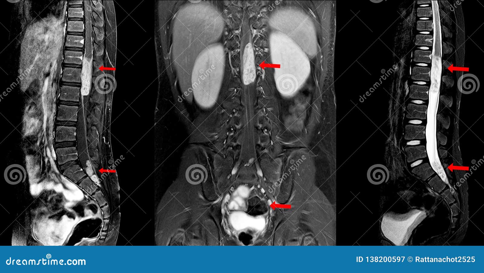 Mri Dorn Der Masse An Der Distalen Schnur Und Am Conus Medullaris Mit
