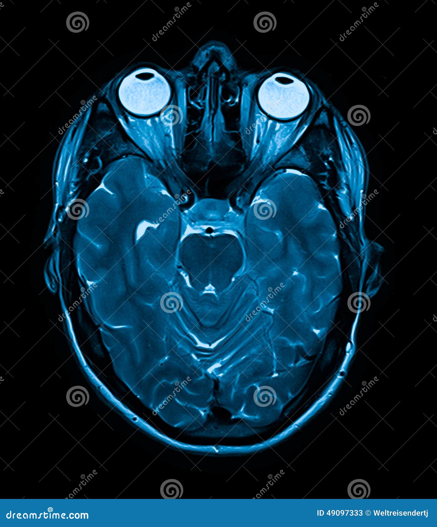 Mri Head Magnetic Resonance Image Stock Image - Image of ...