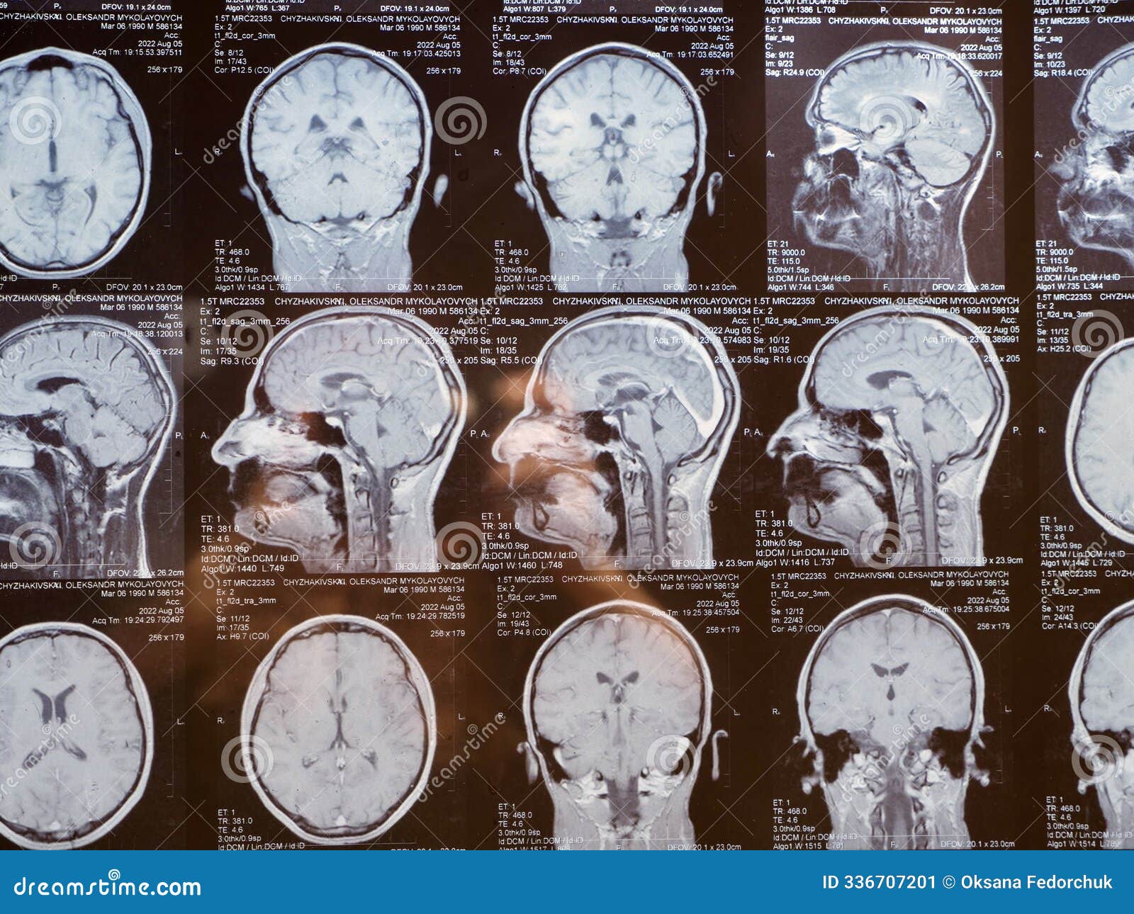 MRI Human Brain with Multiple Sclerosis Stock Image - Image of medical ...