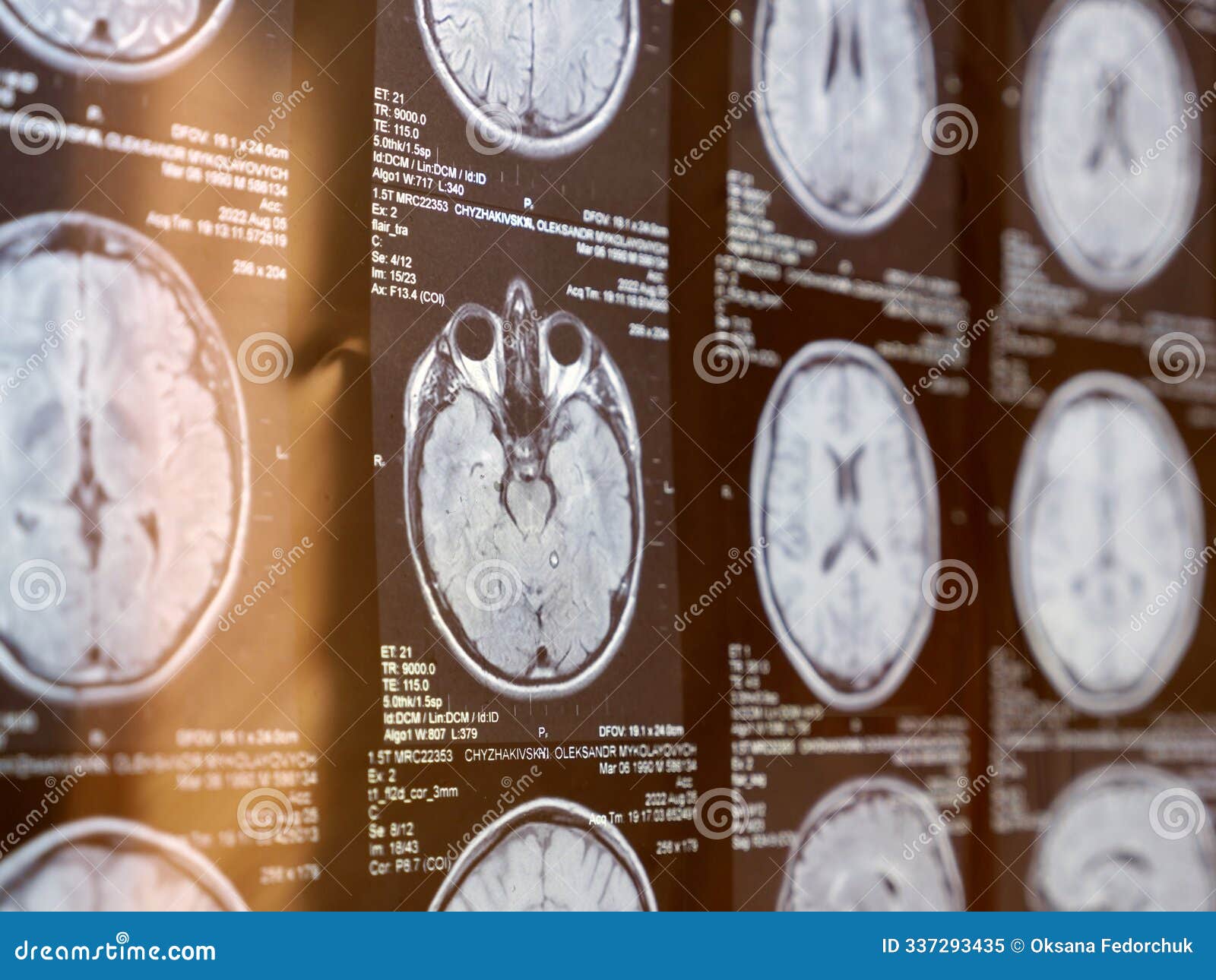 MRI Human Brain with Multiple Sclerosis Stock Image - Image of xray ...