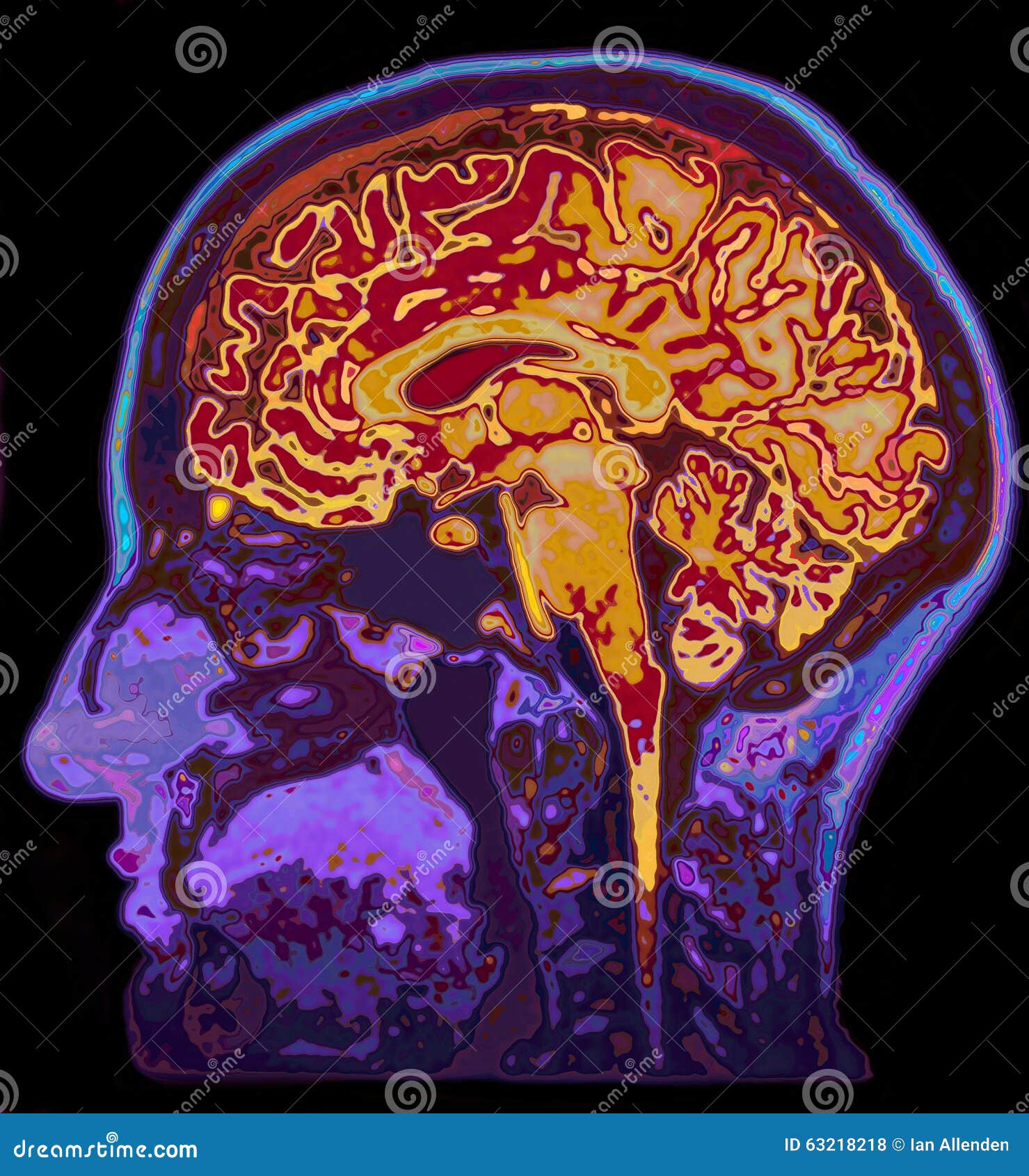 MRI Image of Head Showing Brain Stock Photo - Image of science ...