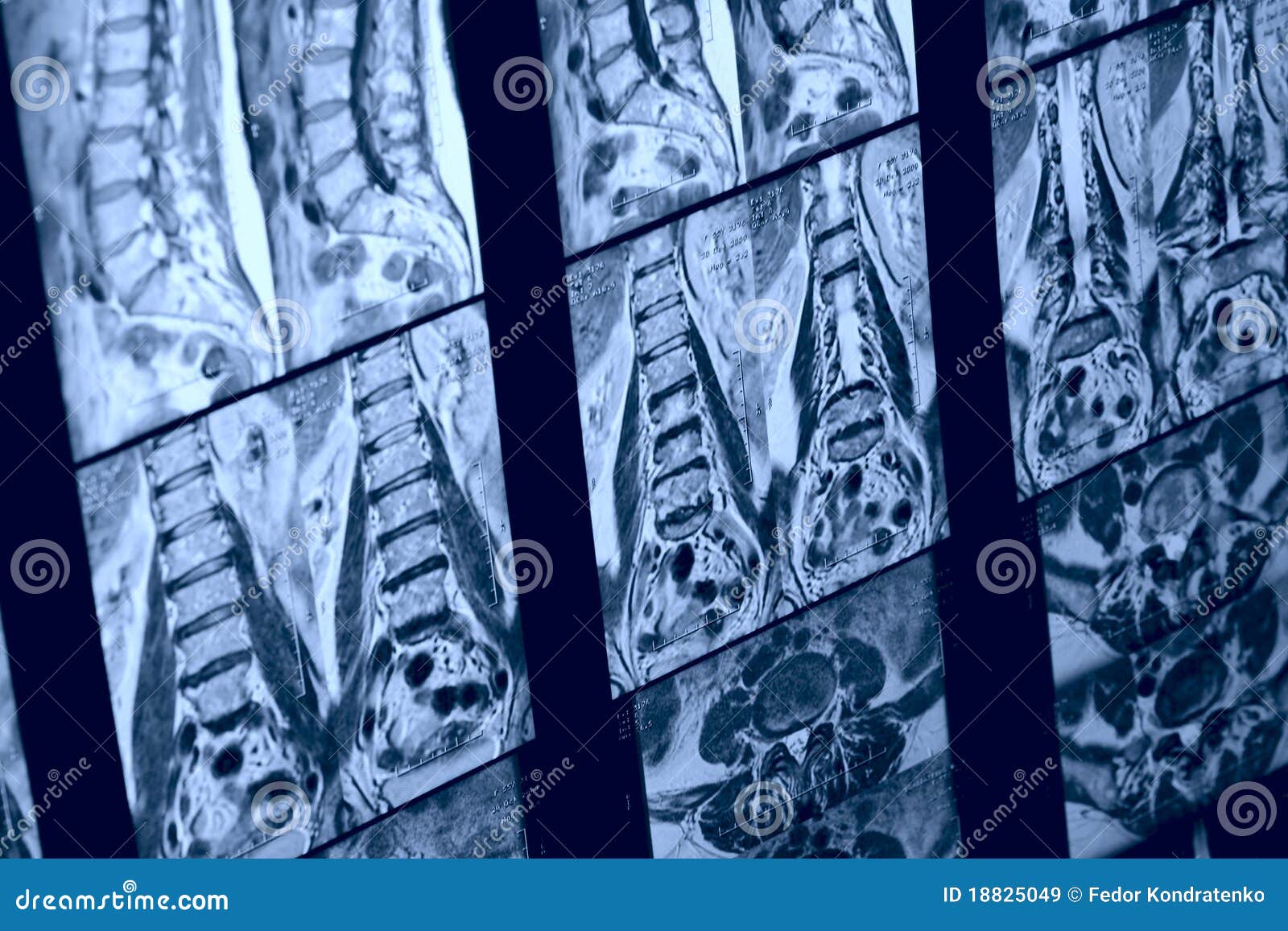 MRI image of human spine stock image. Image of test, spine - 18825049