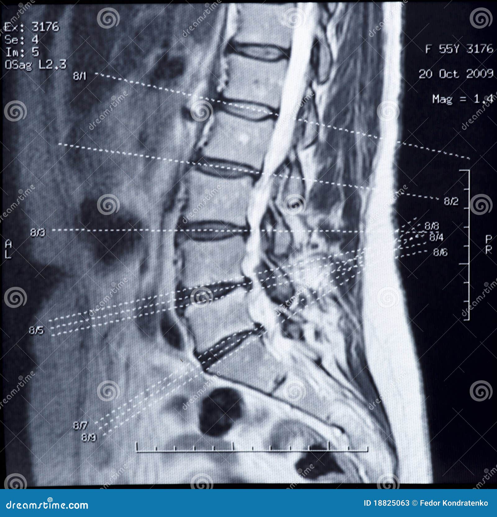 MRI image of human spine stock image. Image of hernia - 18825063