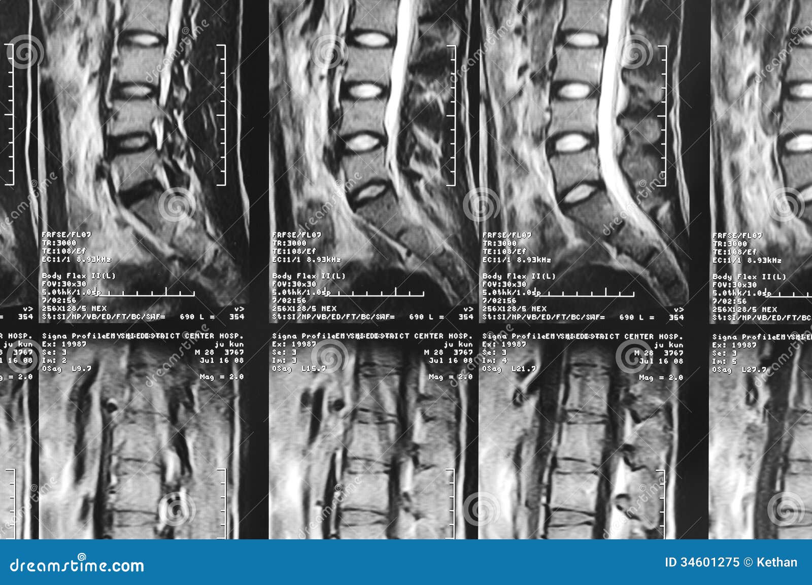 MRI image stock image. Image of coccygeal, radiologist - 34601275