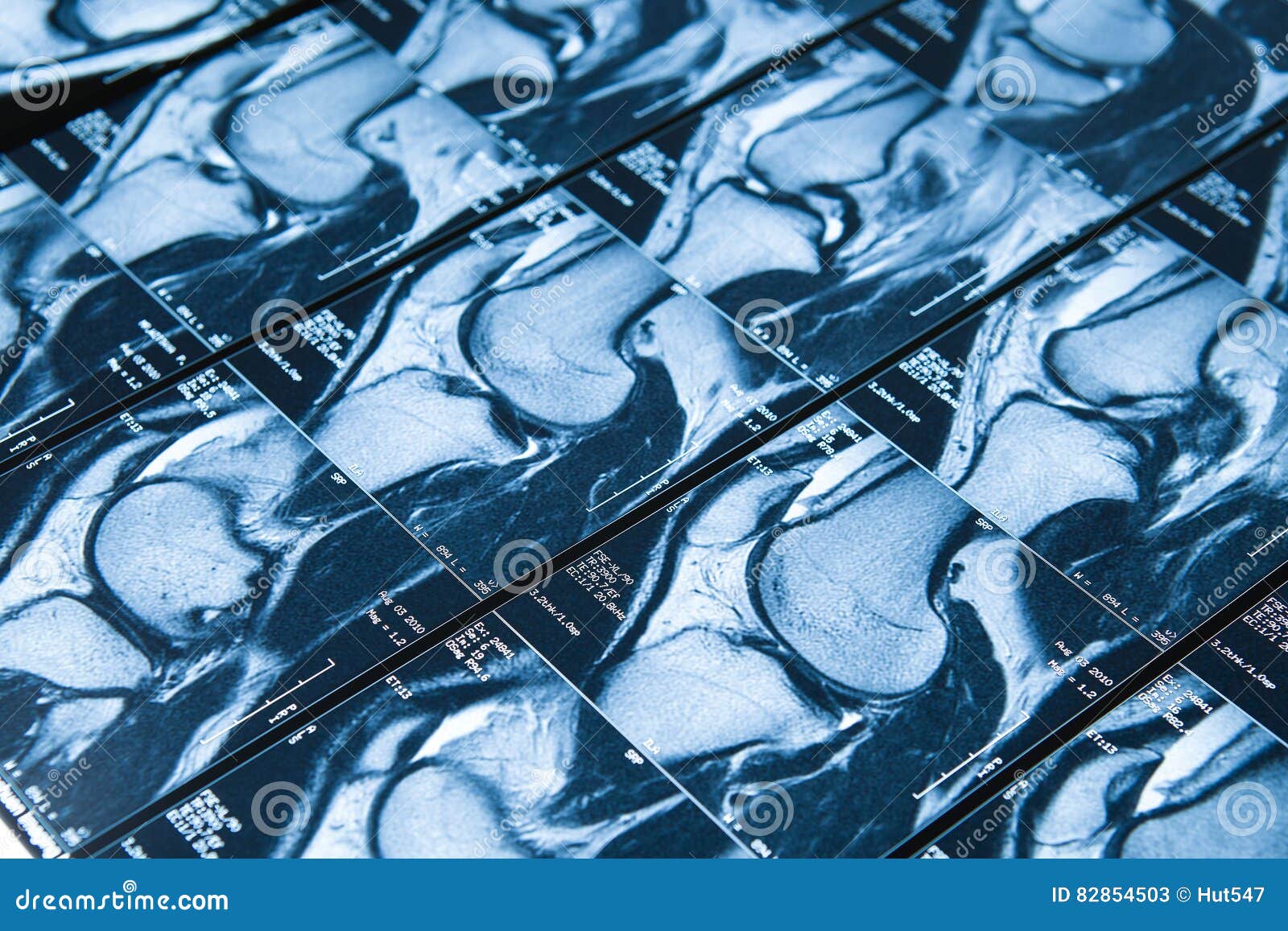 MRI Image of Knee Joint Leg, Damage Stock Image - Image of illness ...