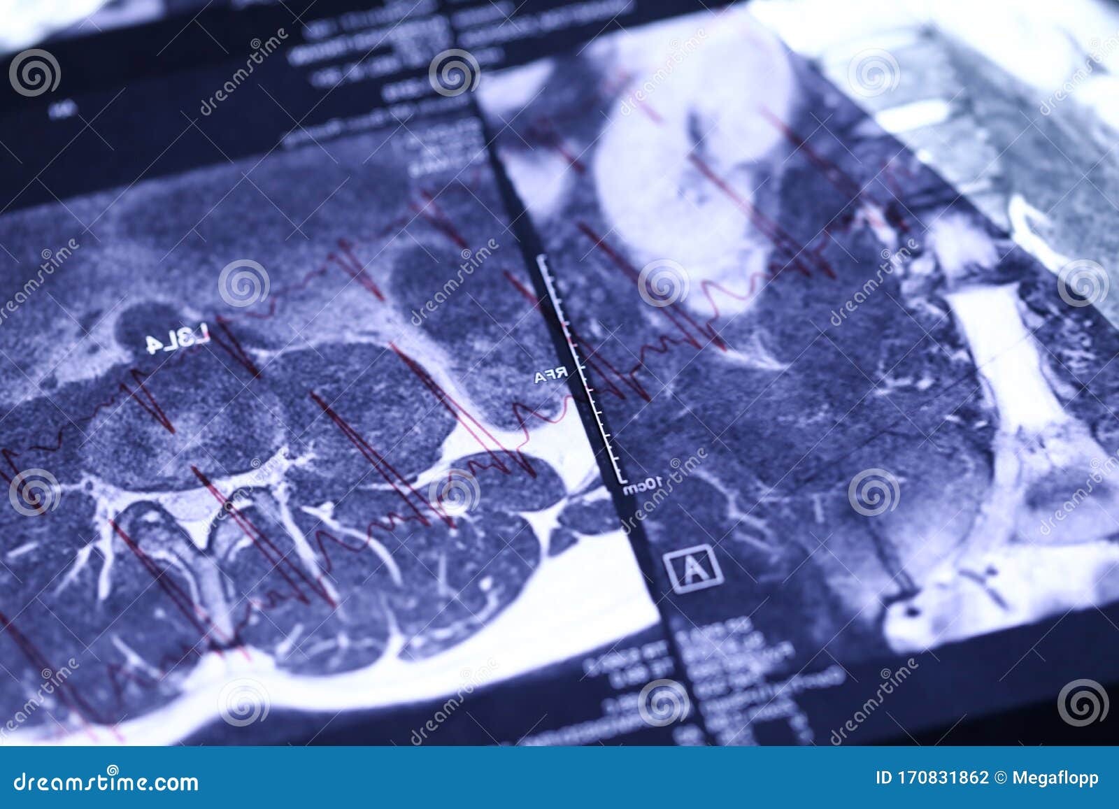 MRI Image Lying Over Cardiogram Chart Stock Photo - Image of abstract ...