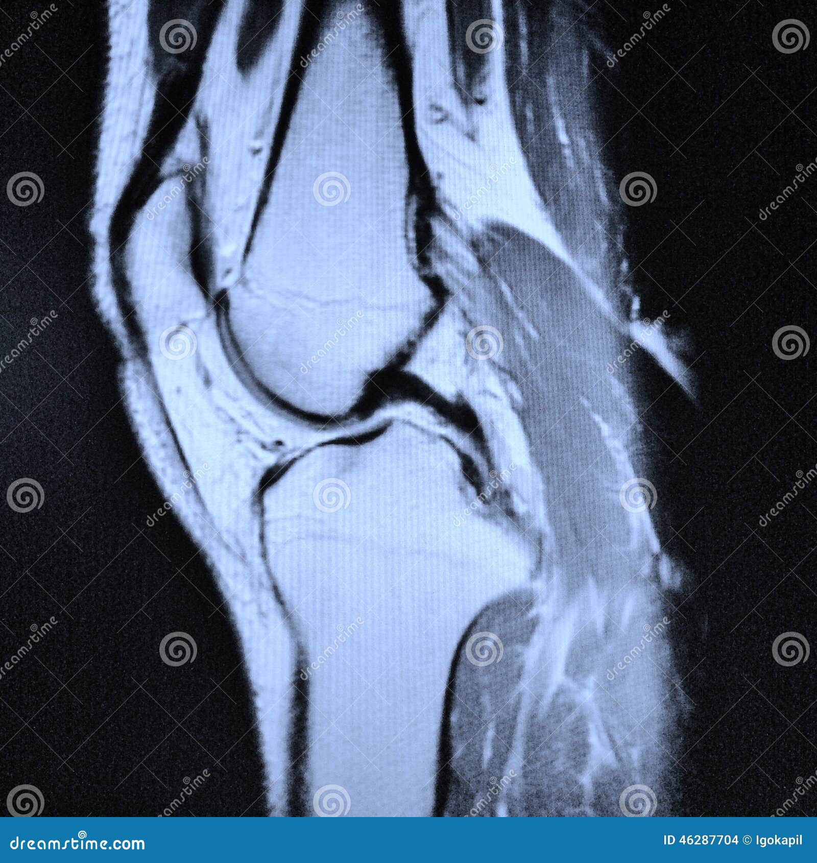 Mri Izquierdo De La Rodilla Foto de archivo - Imagen de tejidos ...