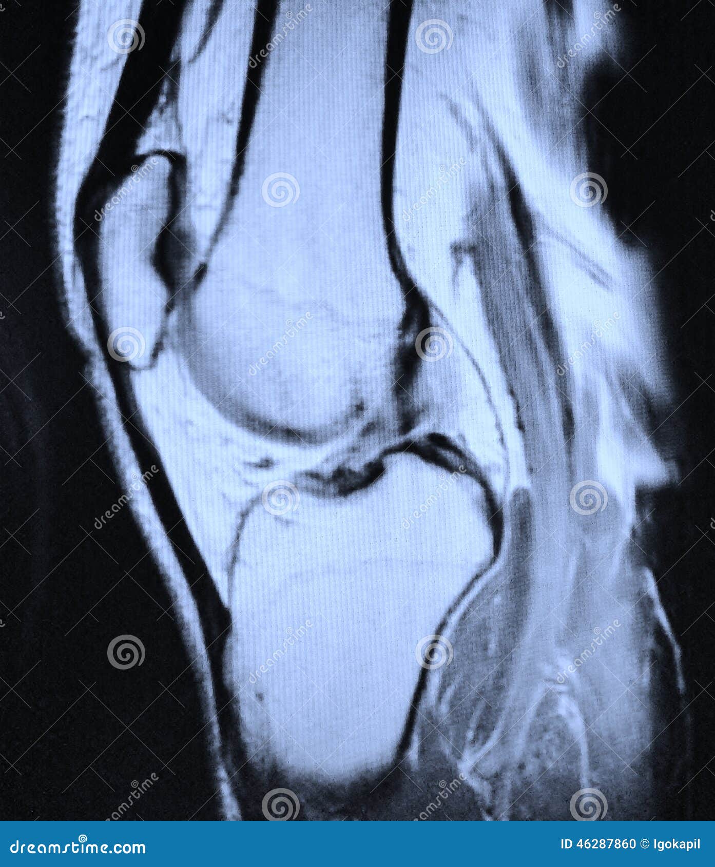 Mri Izquierdo De La Rodilla Foto de archivo - Imagen de trauma, imagen ...