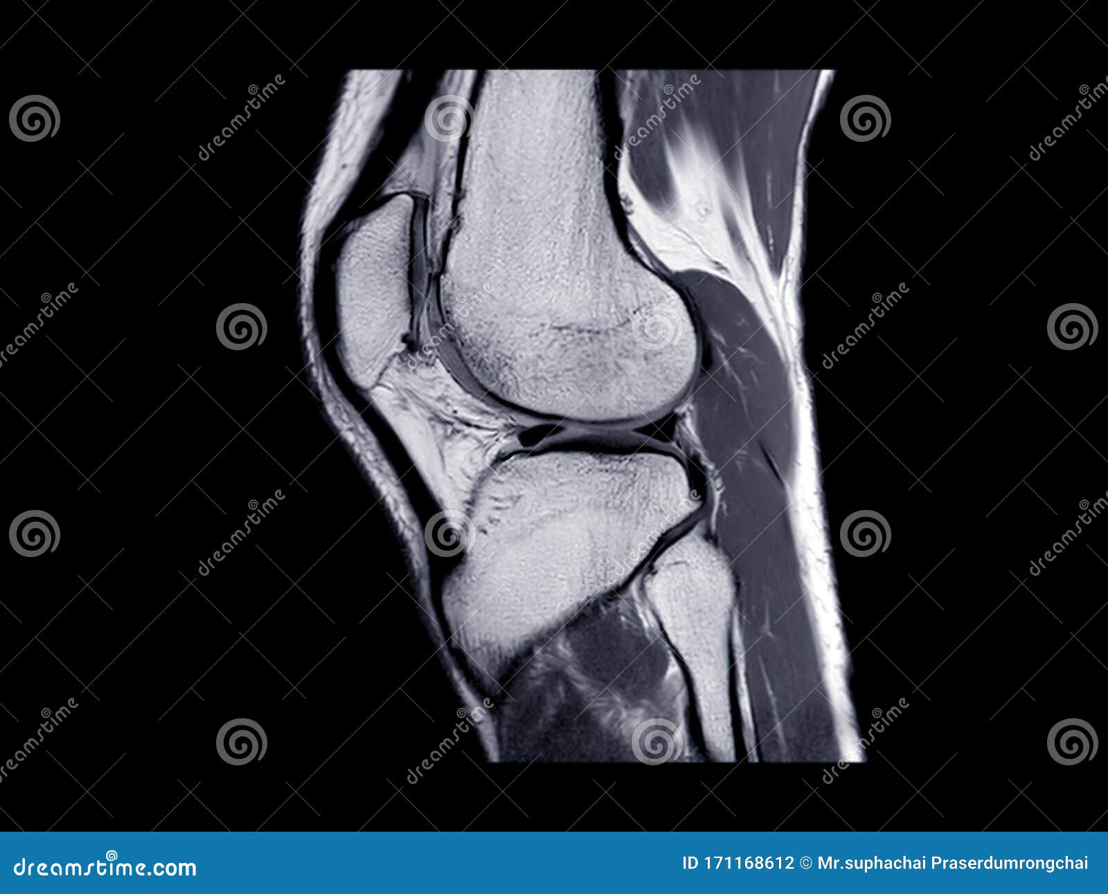 MRI Knee Joint or Magnetic Resonance Imaging Sagittal View. Stock Photo ... MRI Knee Joint or Magnetic Resonance Imaging Sagittal View. Stock Photo ...