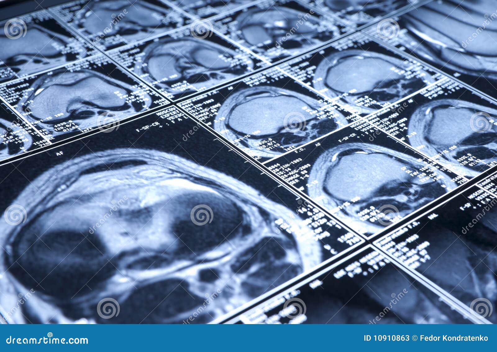 Brain Top View Mri