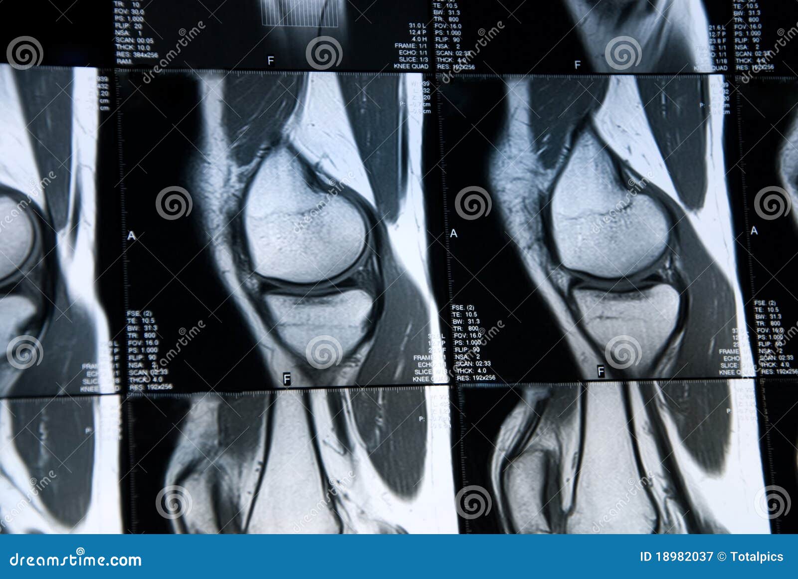Mri Knie stockbild. Bild von platte, bild, meniskus, schmerz - 18982037