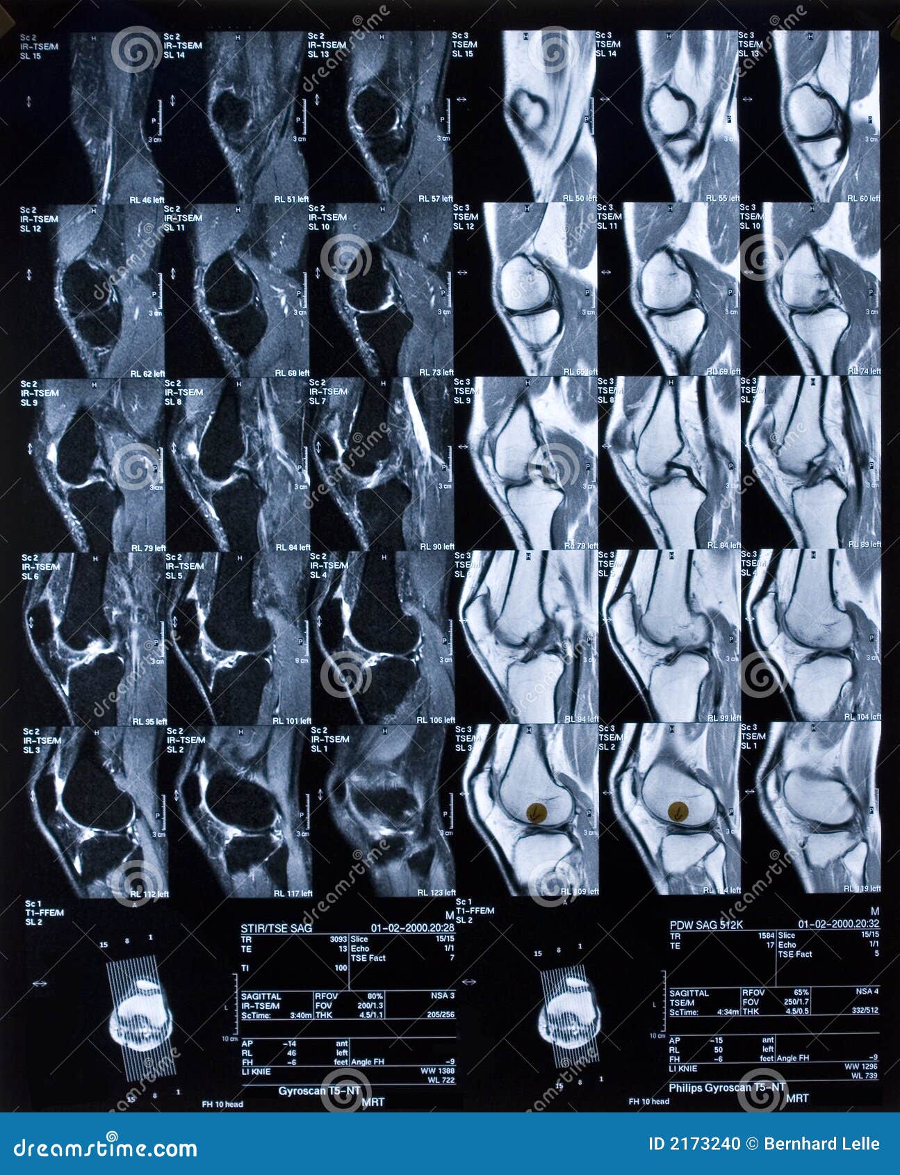 MRI Knie stockfoto. Bild von fahrwerkbein, teile, menschlich - 2173240
