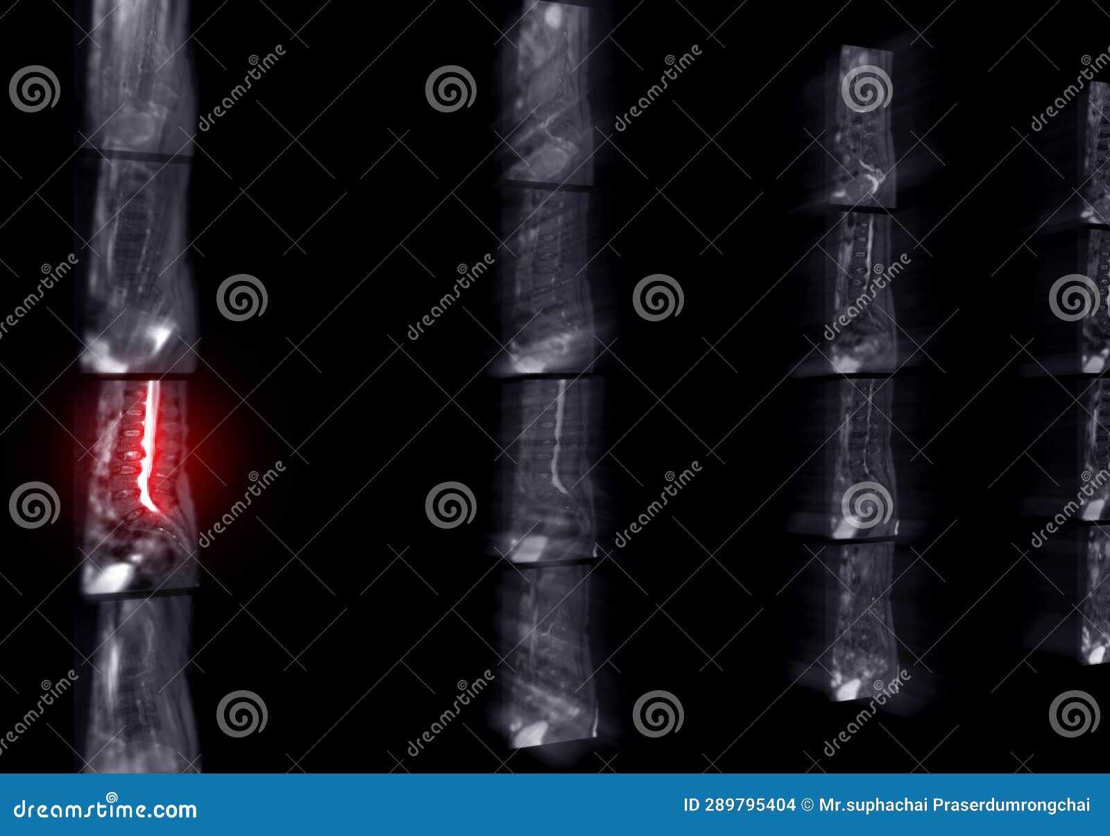 MRI L-S Spine or Lumbar Spine for Diagnosis Spinal Cord Compression ...