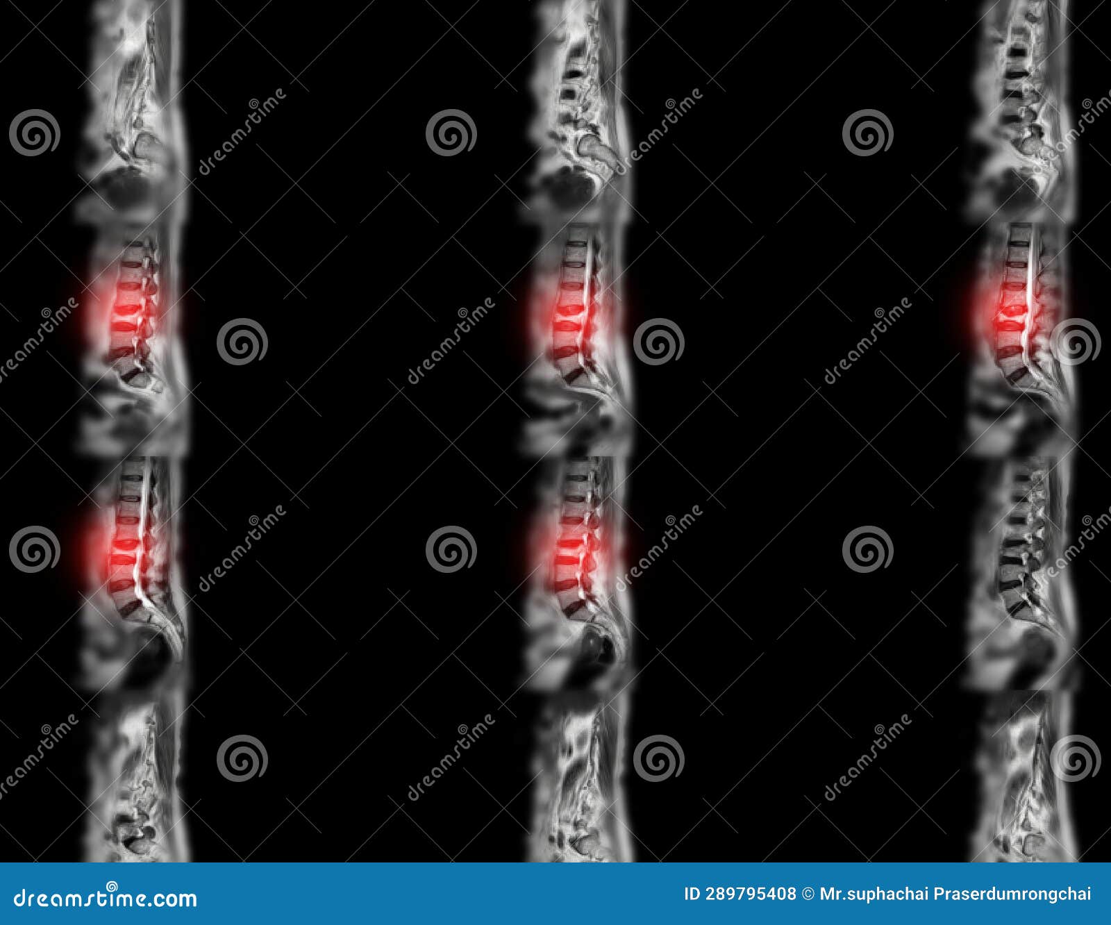 MRI L-S Spine or Lumbar Spine for Diagnosis Spinal Cord Compression ...