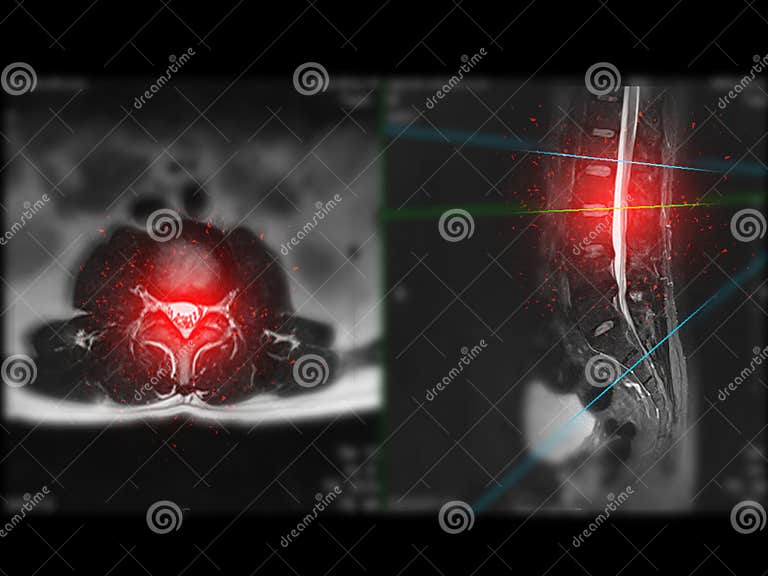 Mri L S Spine Or Lumbar Spine Axial T2w View With Sagittal Plane For