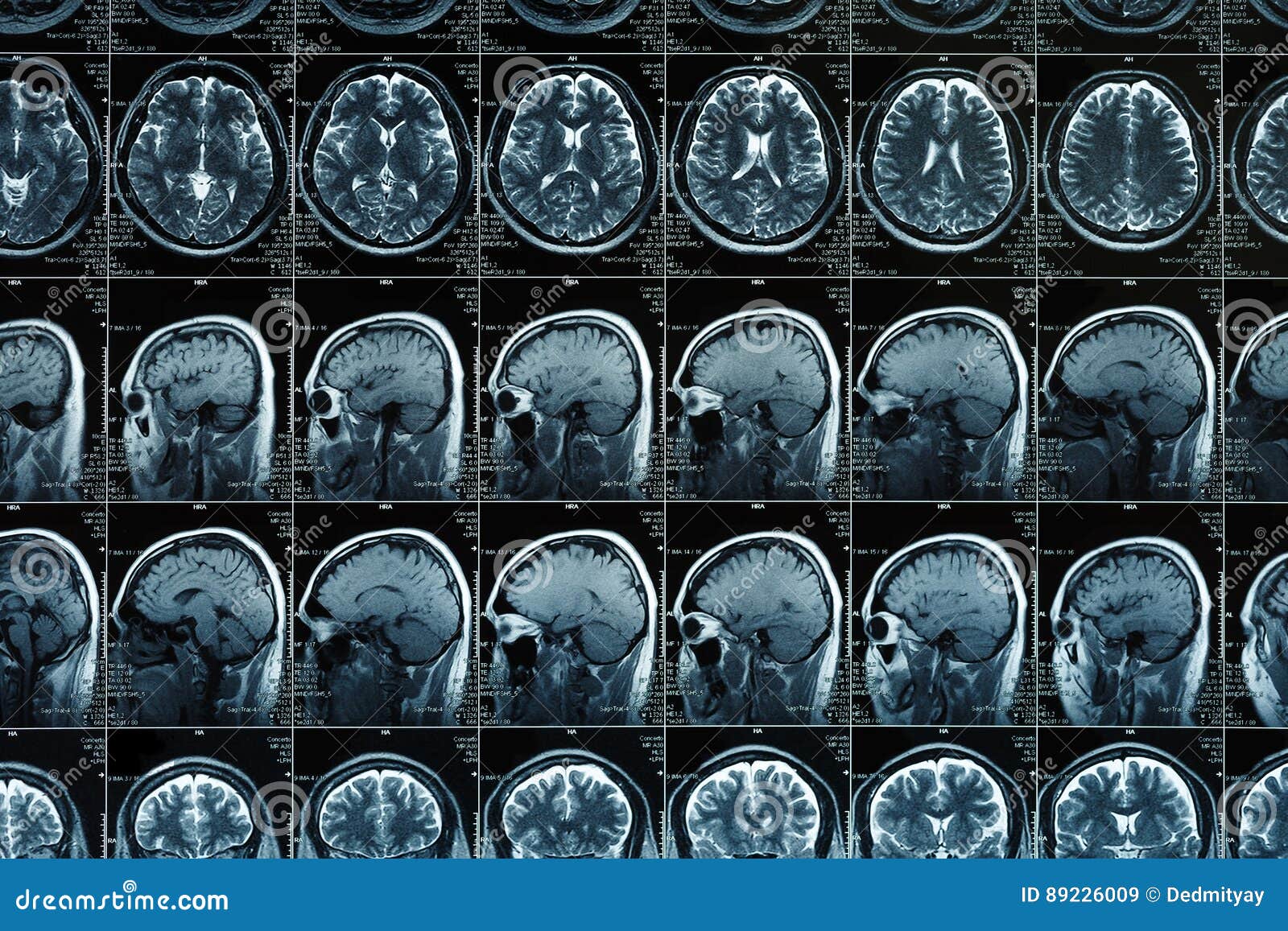 MRI Scan Or Magnetic Resonance Image Of Head And Brain Scan Stock Photo ...