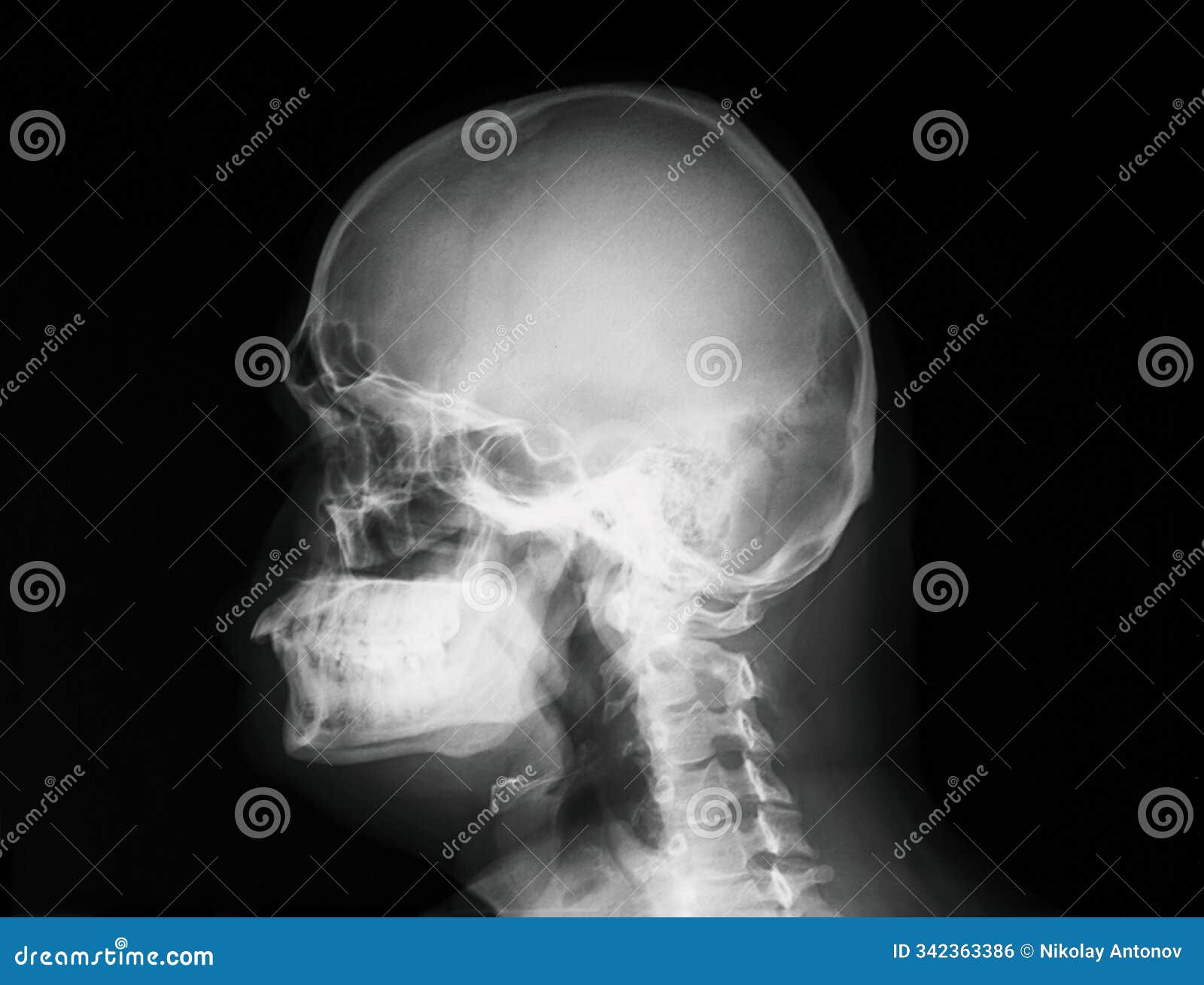 MRI Magnetic Resonance Image of the Human Skull. Side Lateral View ...