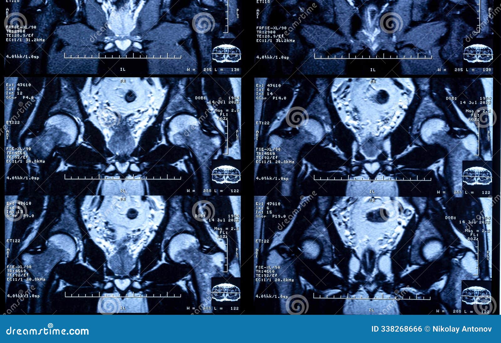 MRI Magnetic Resonance Scan Image of the Hip Joint Stock Photo - Image ...