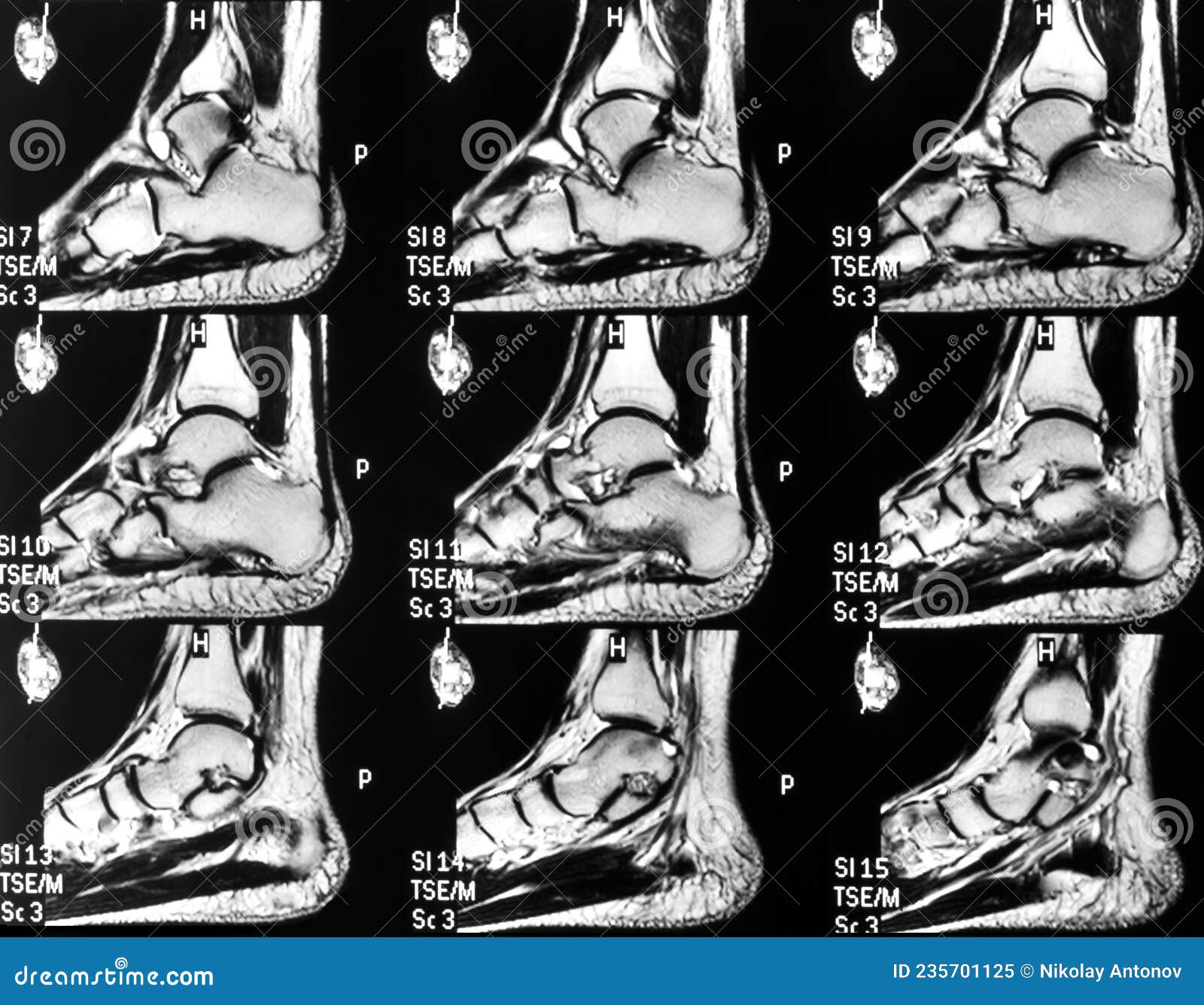 MRI Magnetic Resonance Scan Image of the Left Foot and Ankle Stock ...