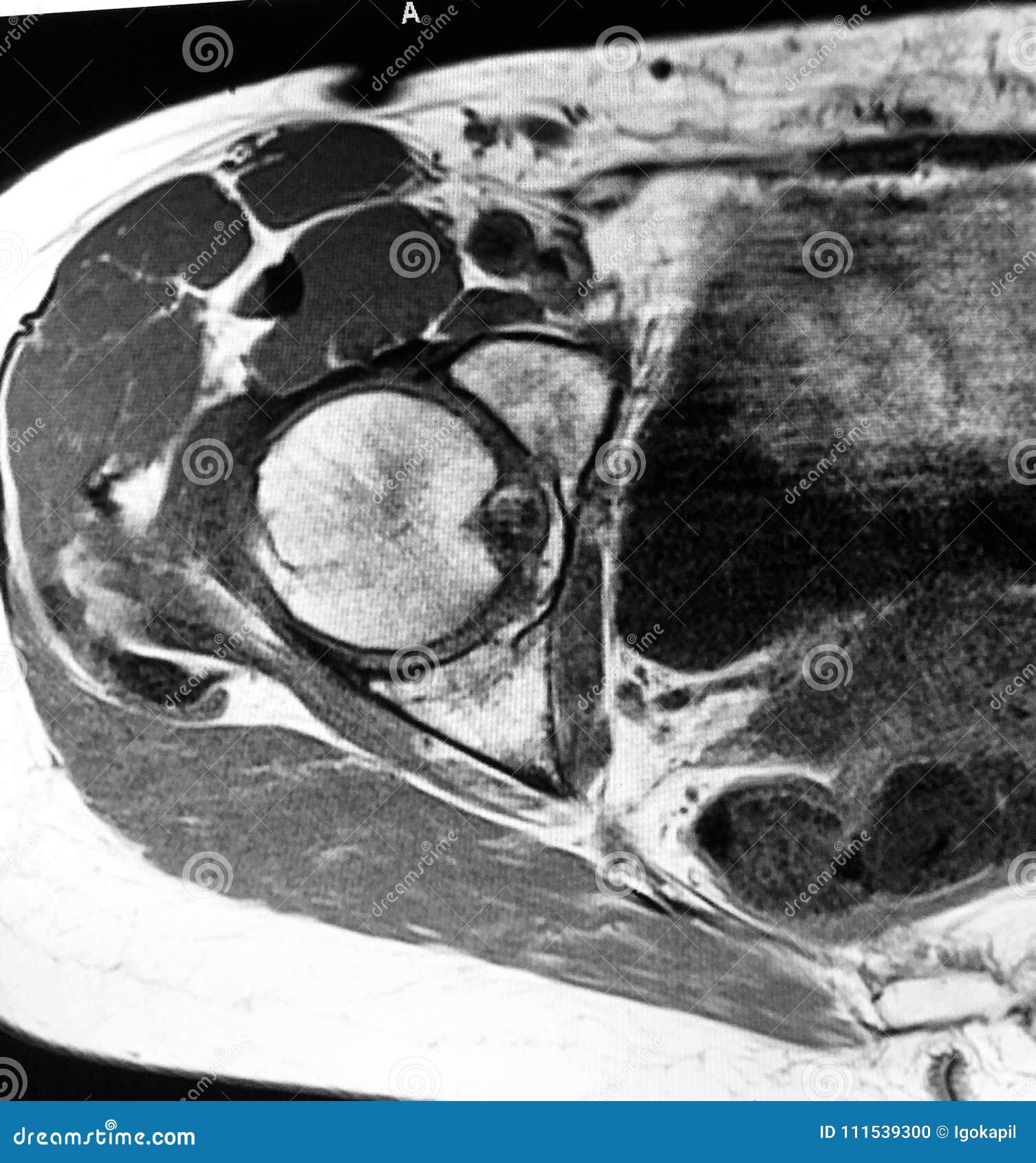 Mri Pathologique De Compression De Corps De Vertèbres Thoraciques Photo ...