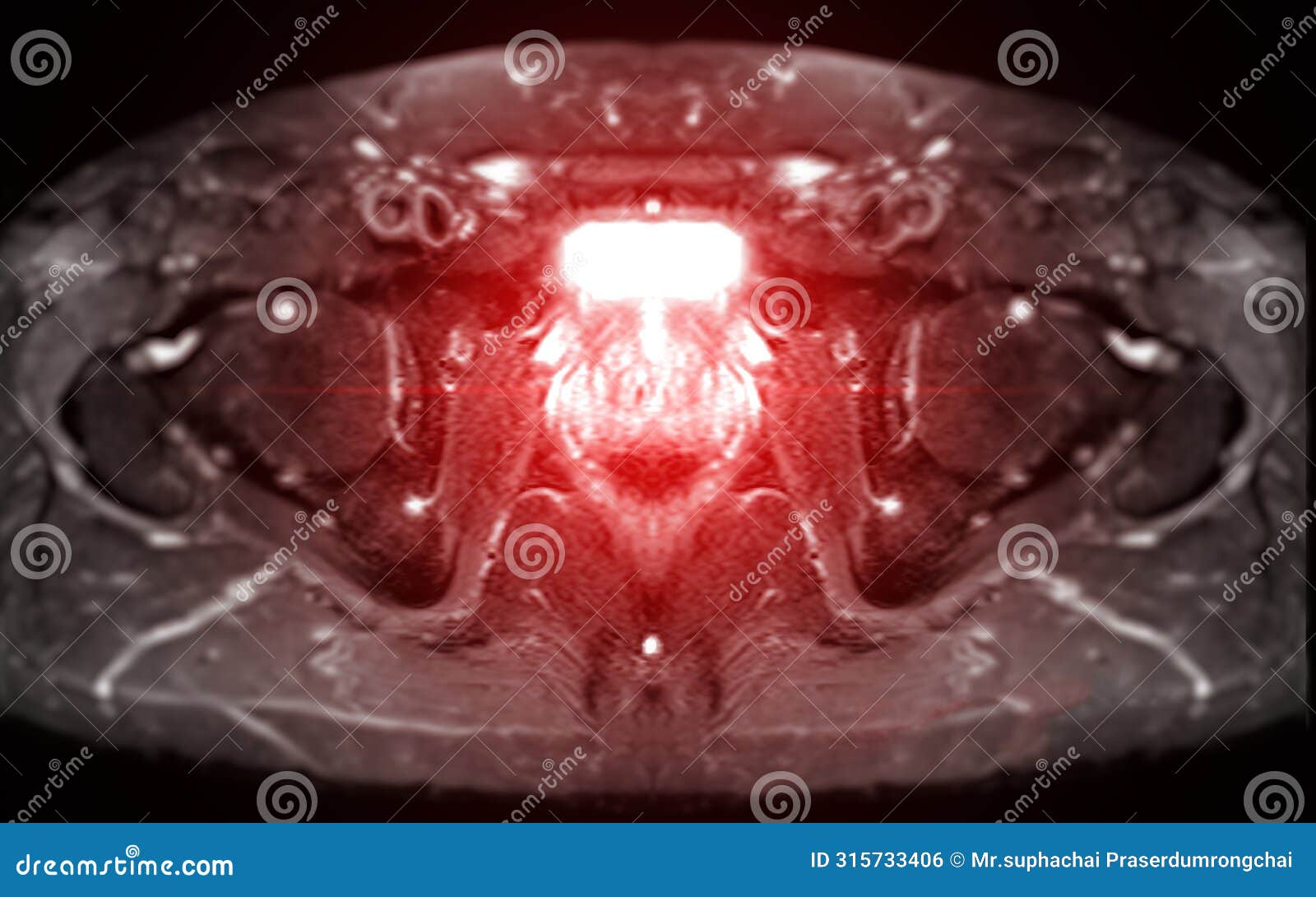 Mri Of The Prostate Gland Reveals Focal Abnormal Si Lesion At Left Pzpl At Apex As Described Pi
