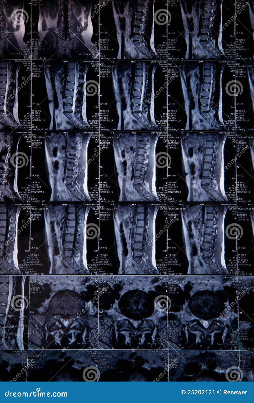 MRI real scan stock image. Image of film, damage, scan - 25202121