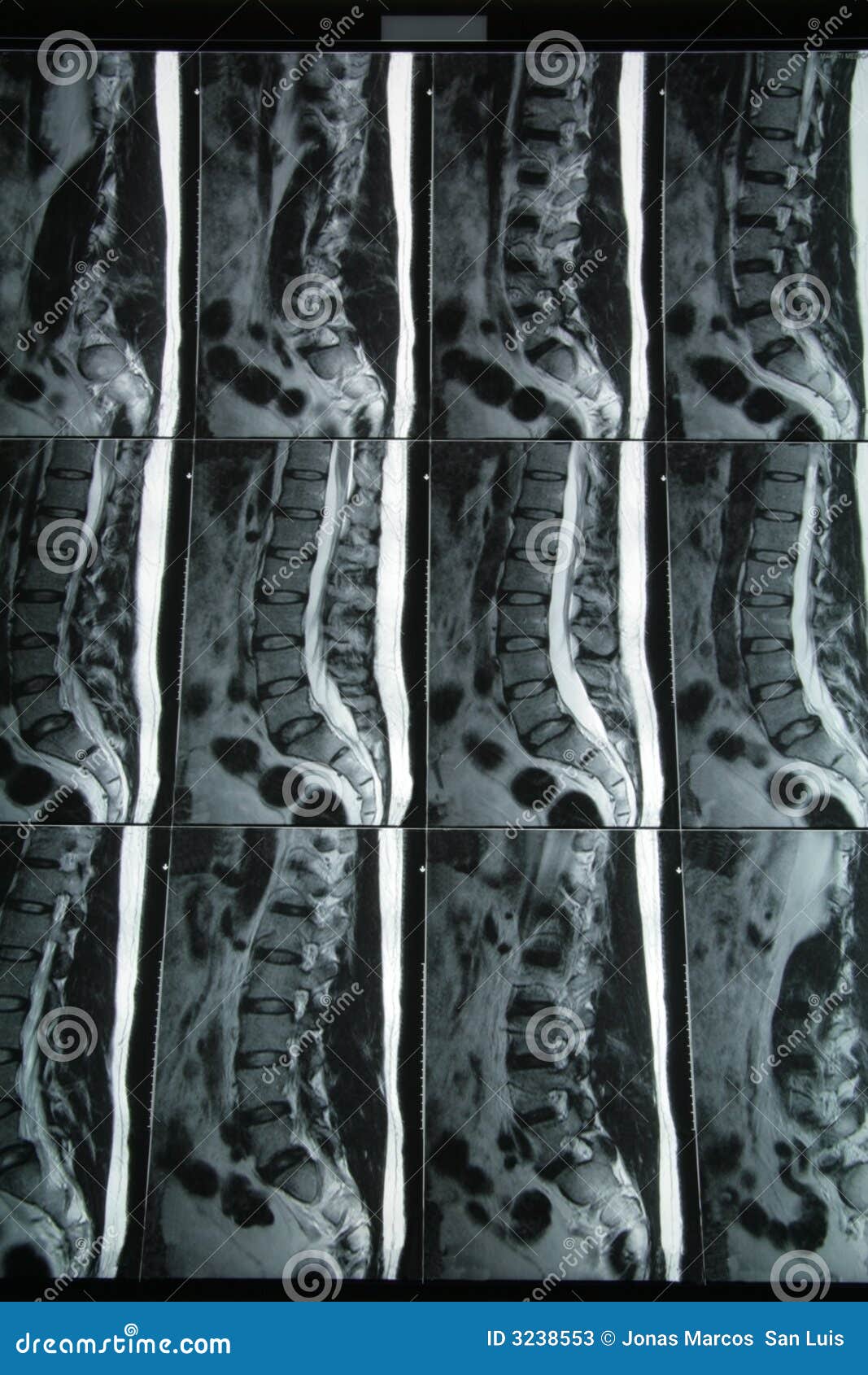 MRI result 2 stock image. Image of medical, magnetic, bone - 3238553