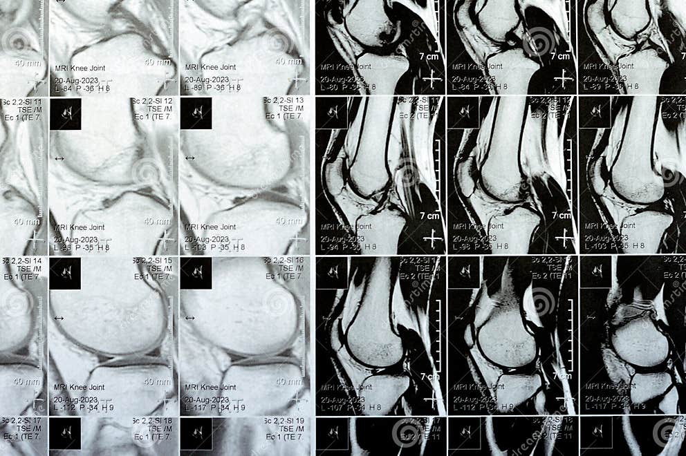 Mri Of The Right Knee Showing Mild Joint Effusion With Normal Other Findings Of Phmm Acl Mcl